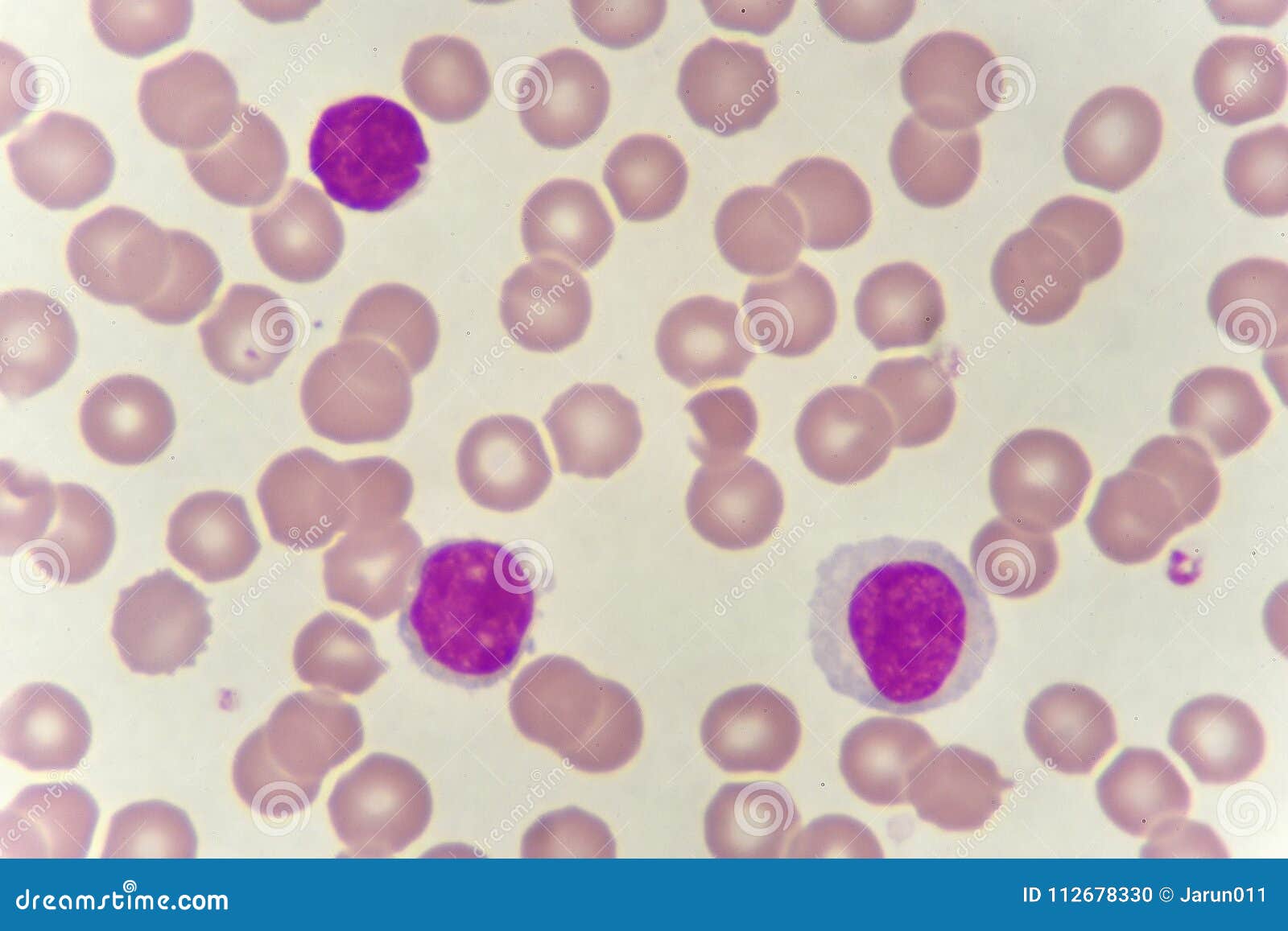Leukemia Cells in Blood Smear Stock Photo - Image of leukemia ...
