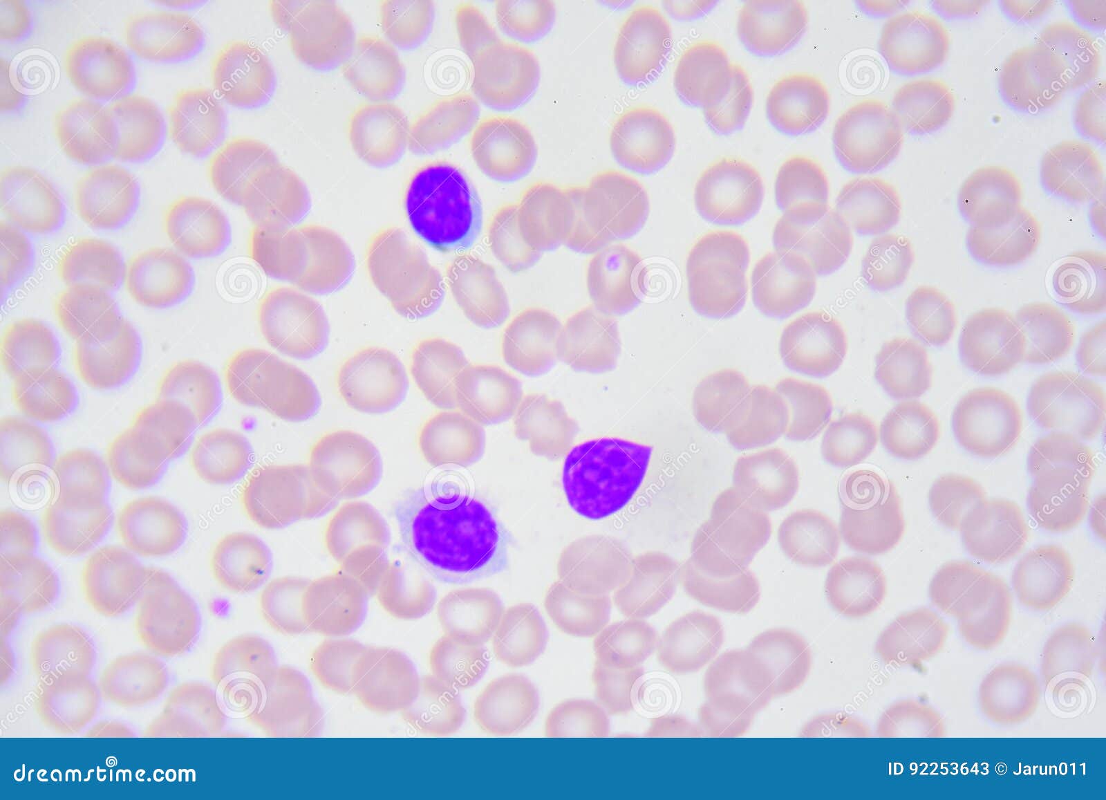 Leukemia cells stock image. Image of leukemia, monocyte - 92253643
