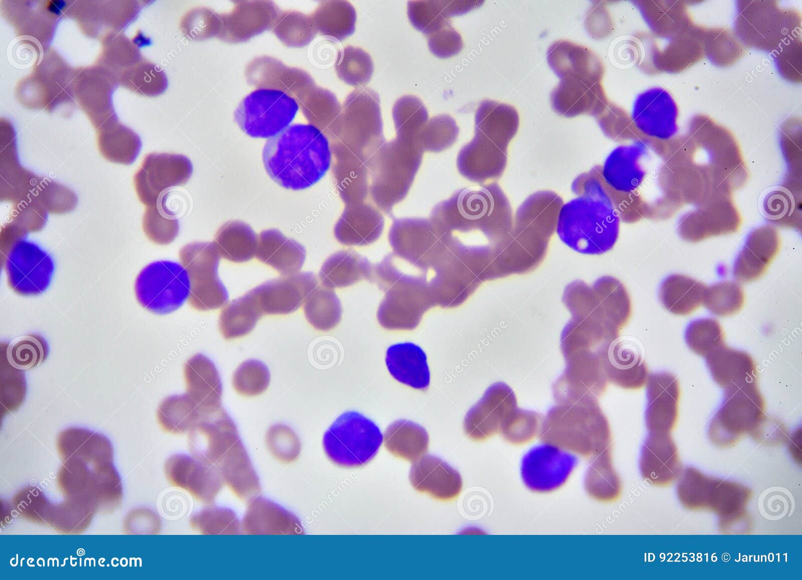 Leukemia cells stock photo. Image of neutrophil, eosinophil - 92253816