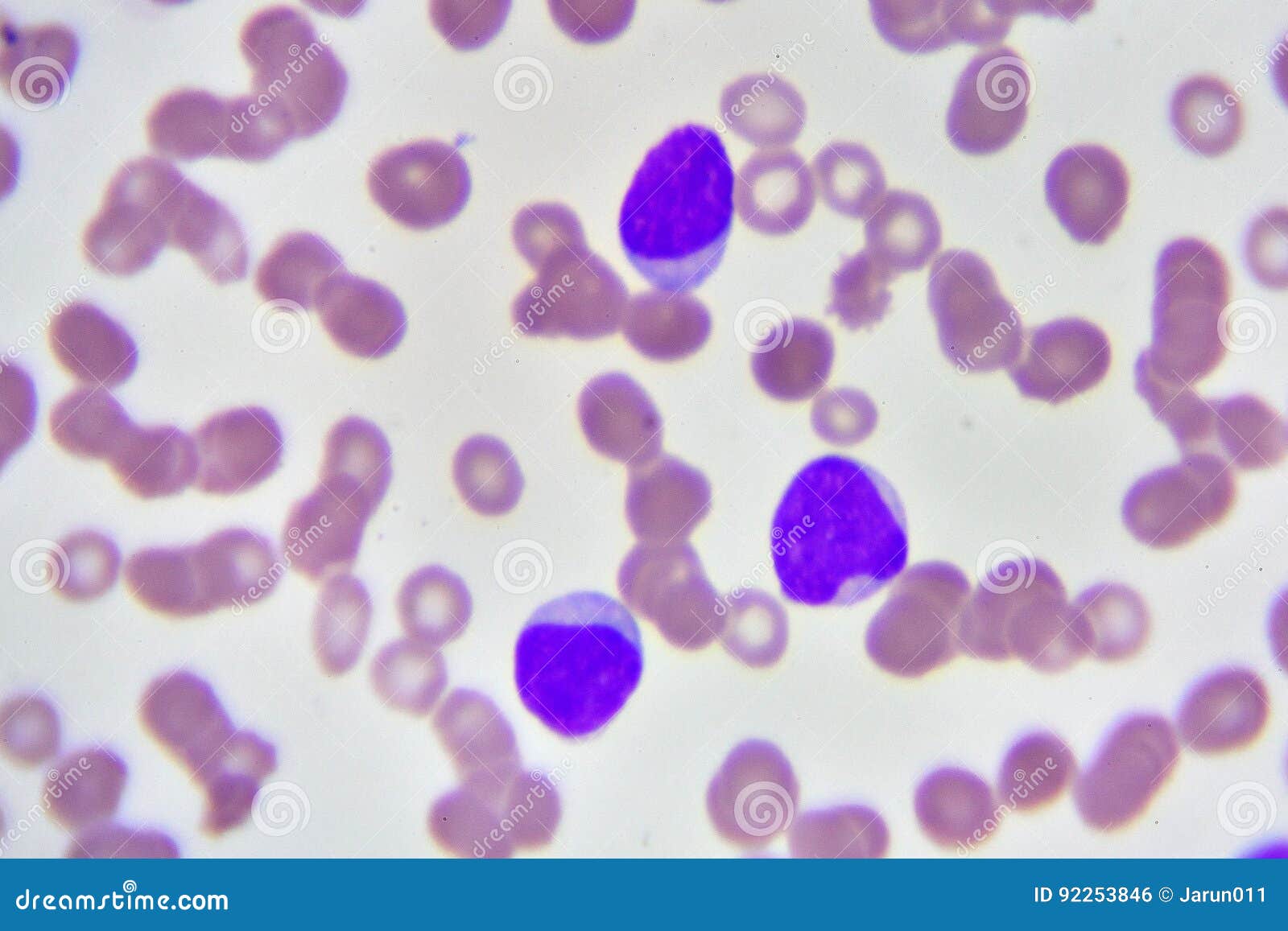 Leukemia cells stock photo. Image of disease, microscopy - 92253846