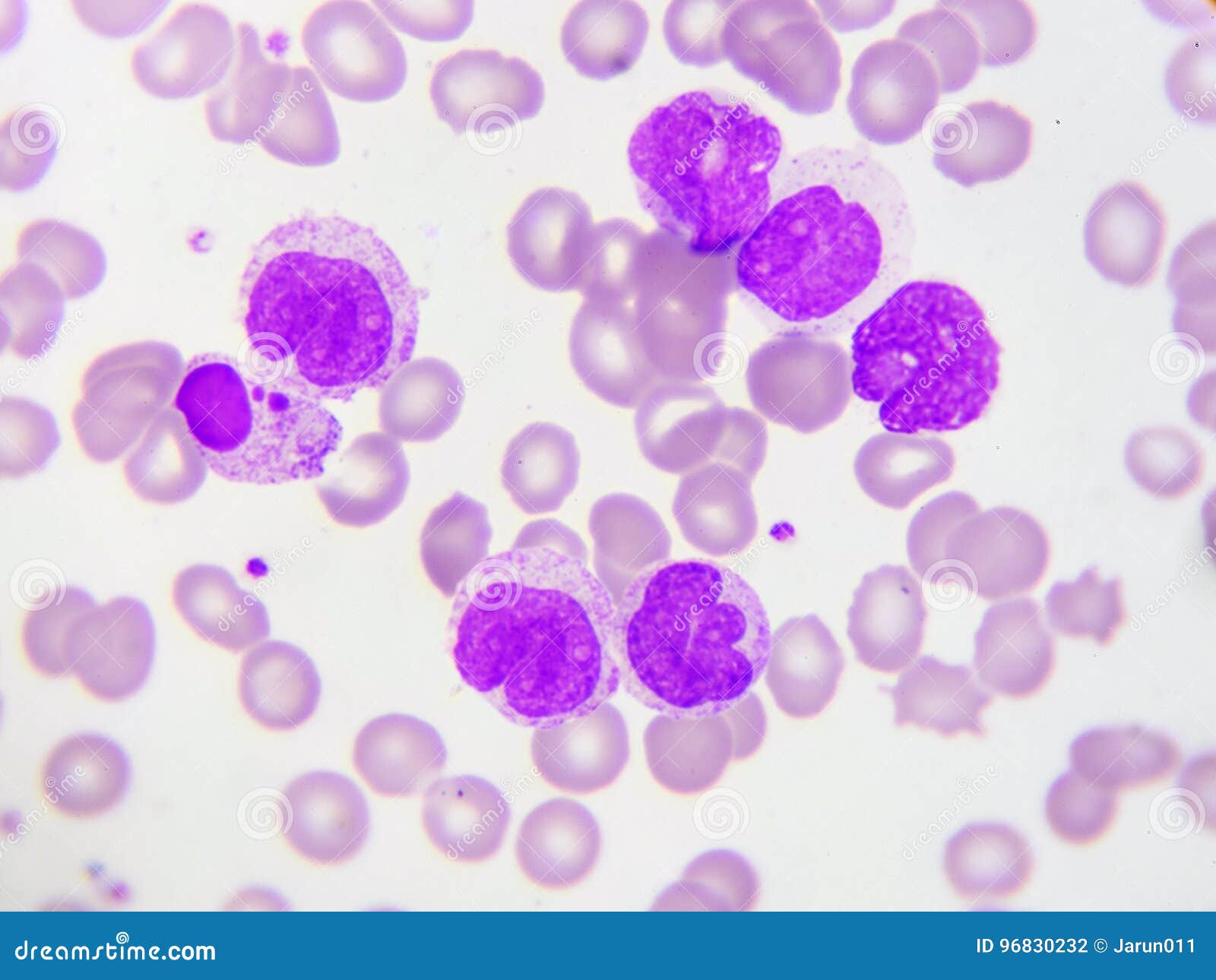 Leukemia Cells In Blood Smear Stock Image | CartoonDealer.com #106683061