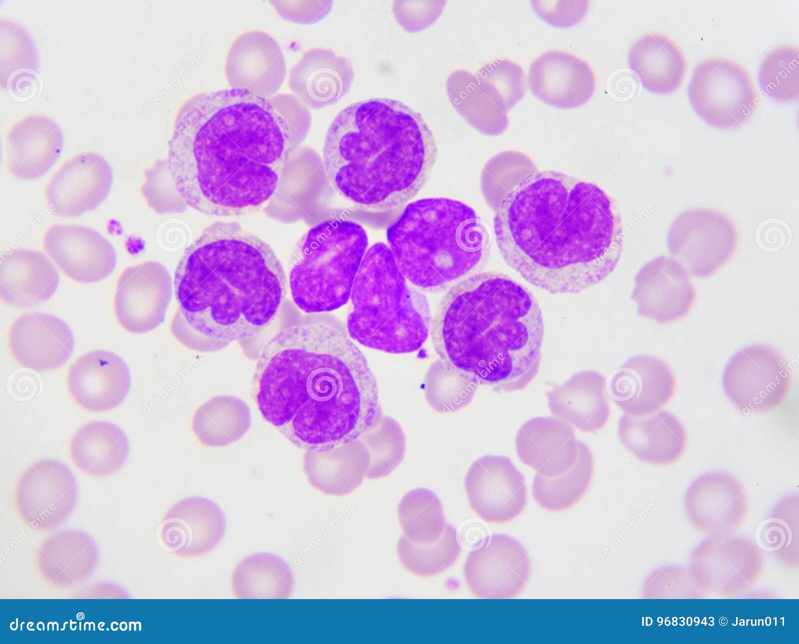 Leukemia Under Microscope