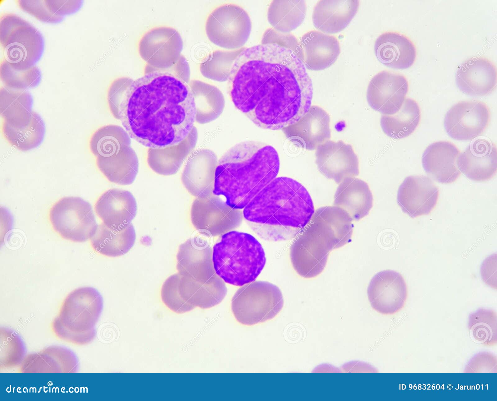 Leukemia Cells In Blood Smear Stock Photography | CartoonDealer.com ...