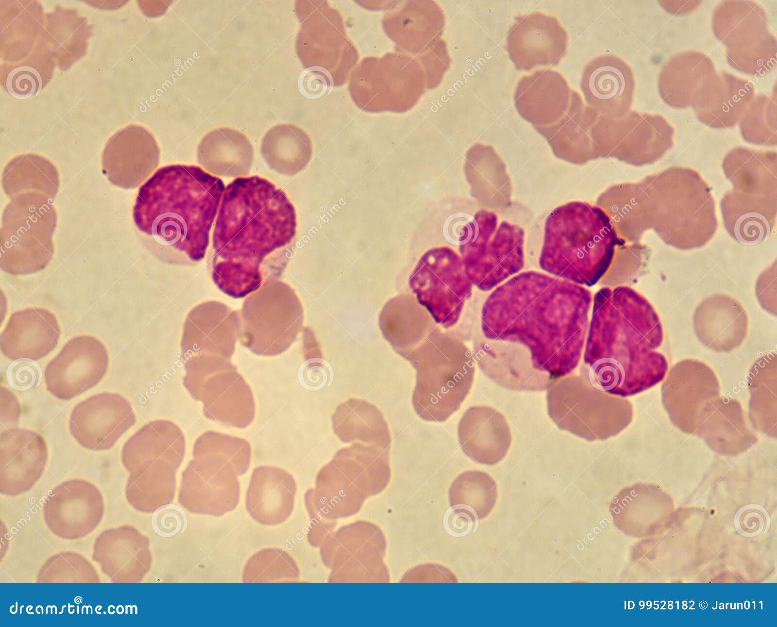 Leukemia cells stock photo. Image of hematology, health - 99528182