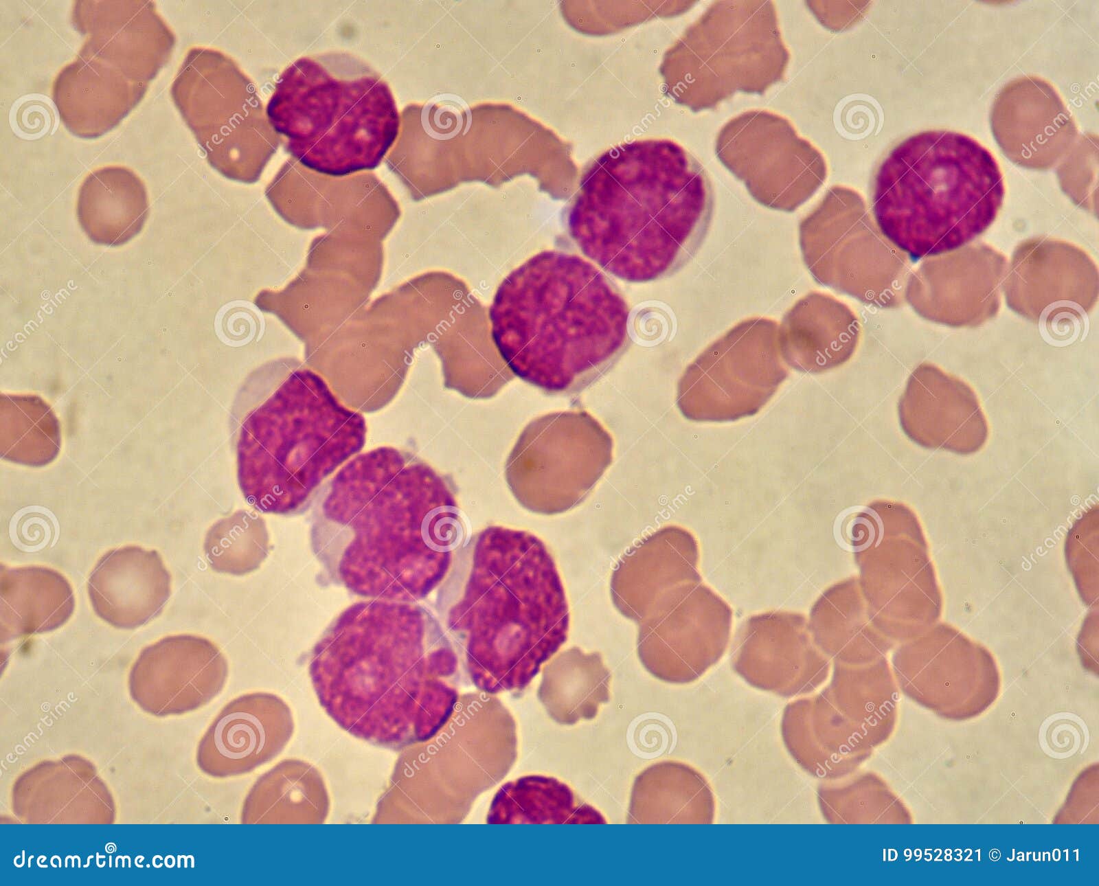 Leukemia cells stock image. Image of microscopic, eosinophil - 99528321