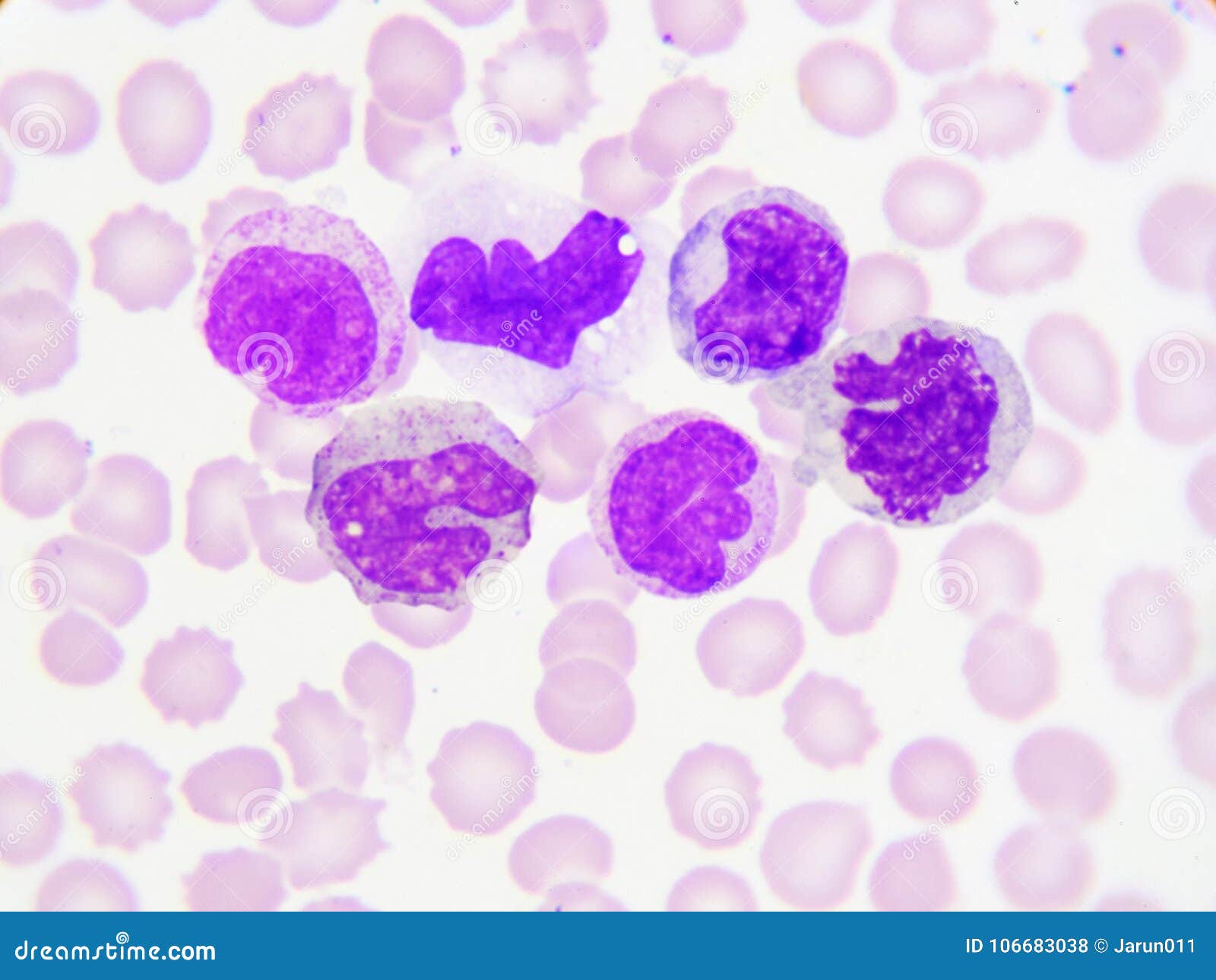 Leukemia Cells In Blood Smear Stock Photography | CartoonDealer.com ...