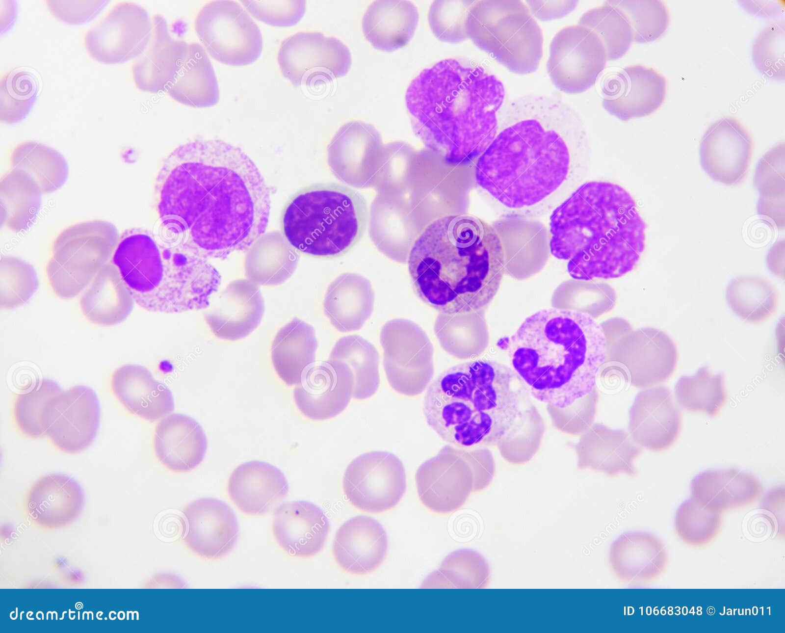 Leukemia Cells in Blood Smear Stock Photo - Image of anemia, blood ...