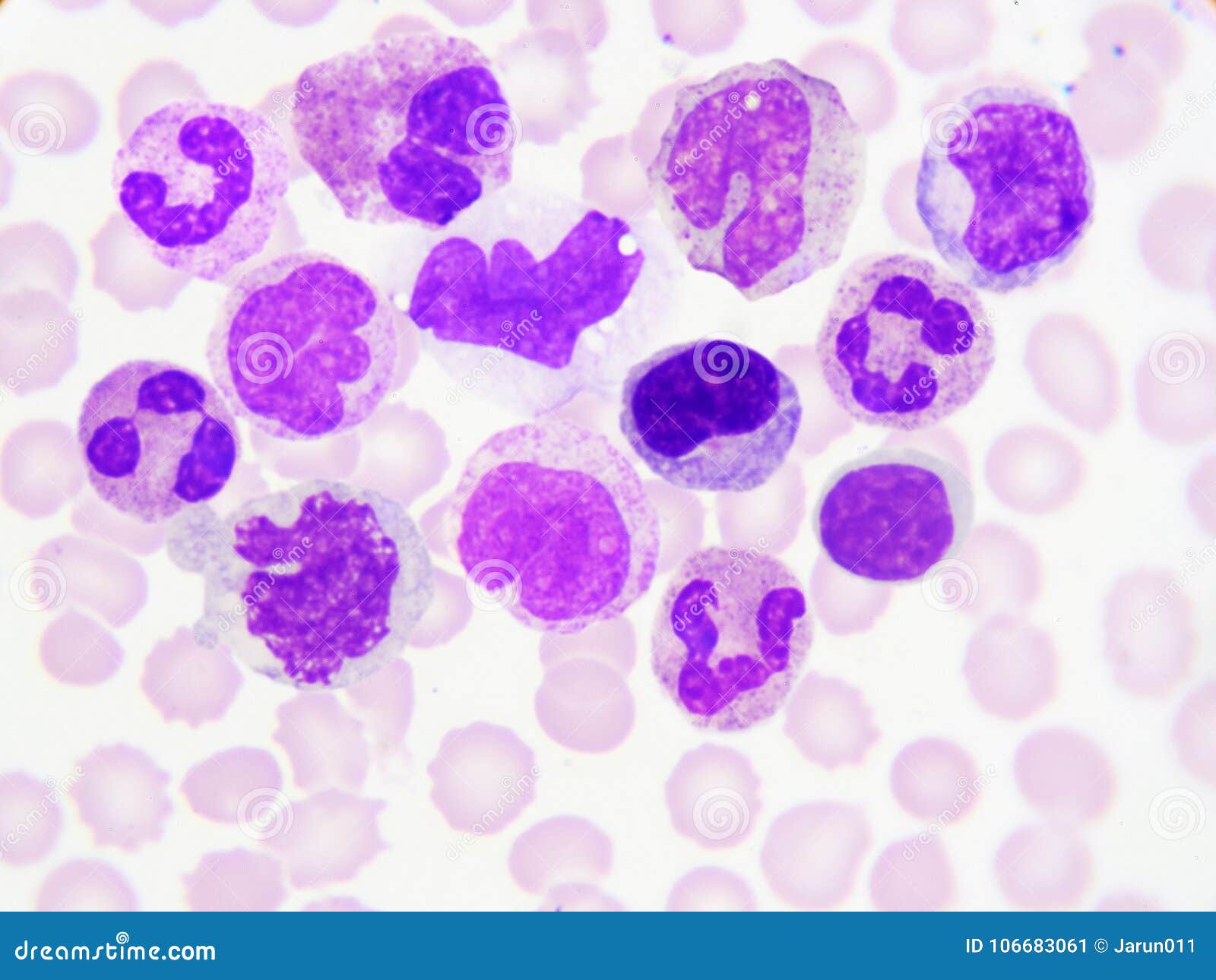 Leukemia Cells in Blood Smear Stock Image - Image of microscopic ...