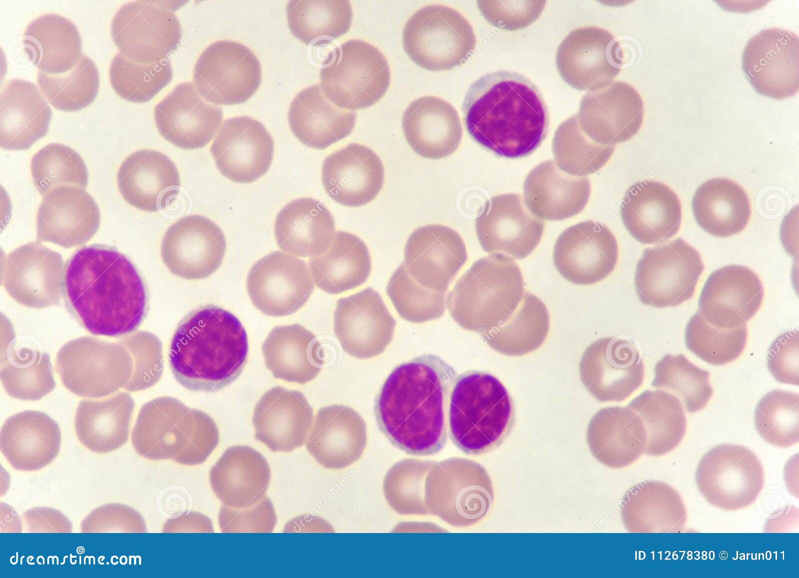 Leukemia Cells in Blood Smear Stock Photo - Image of abnormal, cells ...