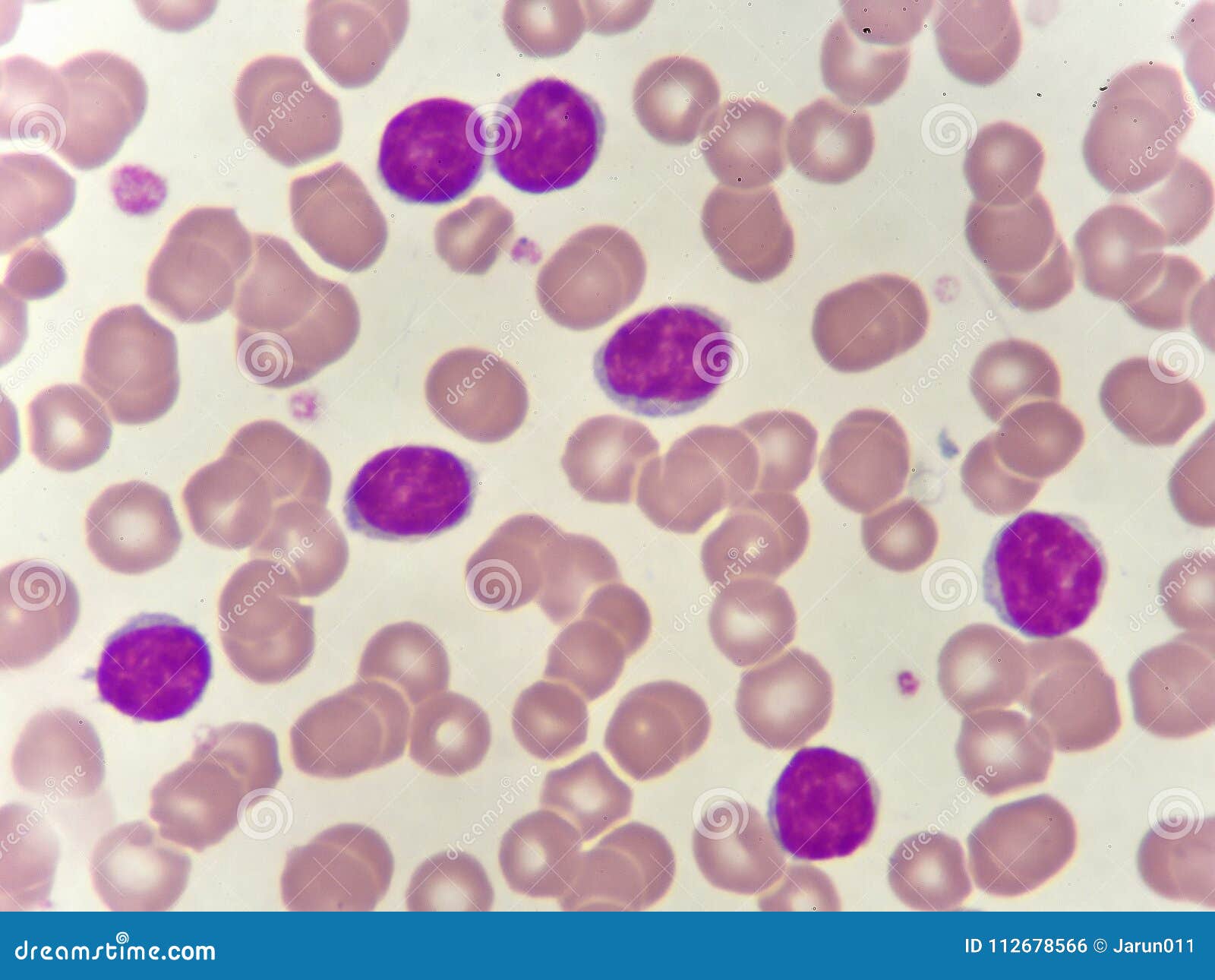 Leukemia Cells In Blood Smear Stock Photo | CartoonDealer.com #106683048