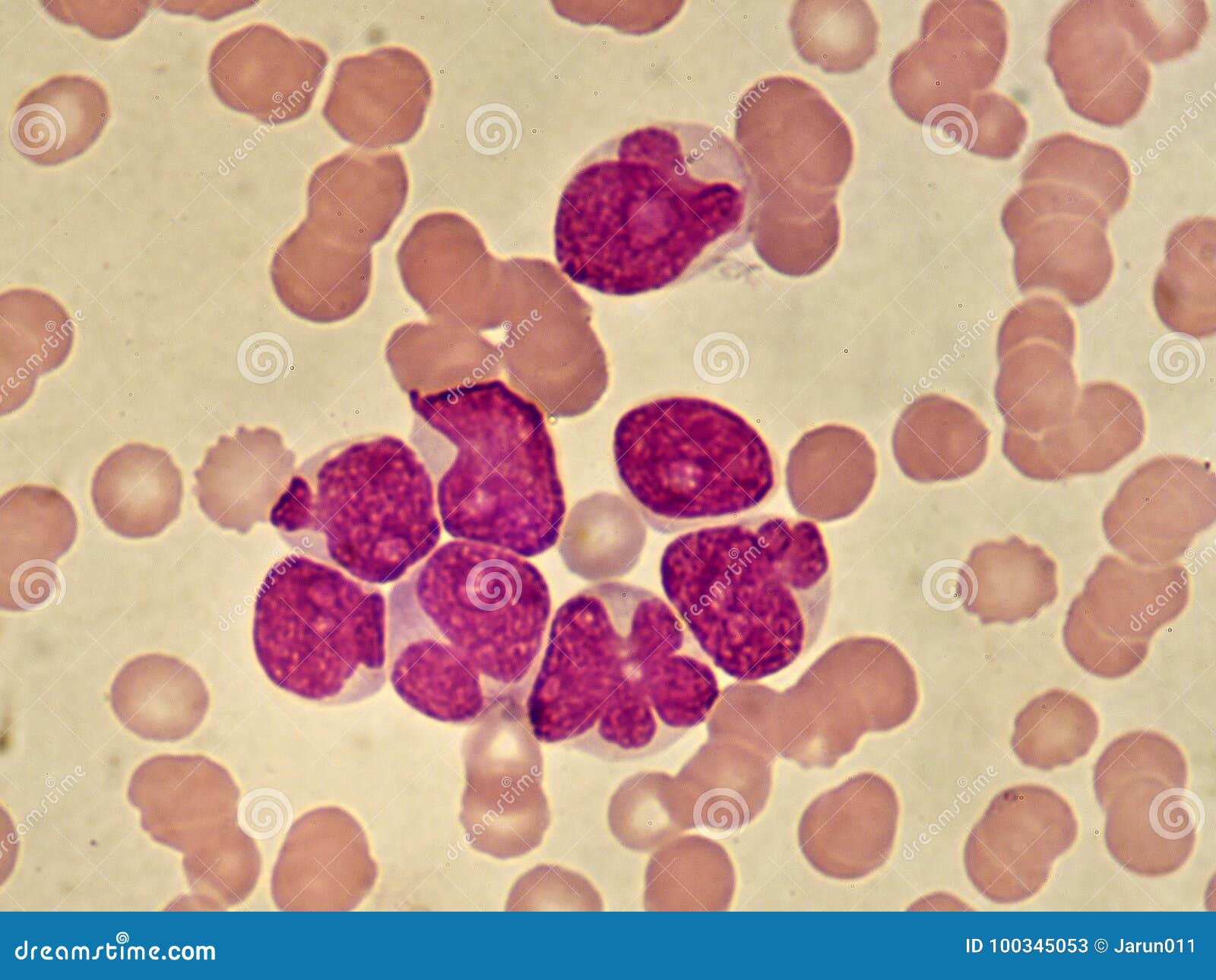 Leukemia cells stock image. Image of hematopoiesis, leukemia - 100345053