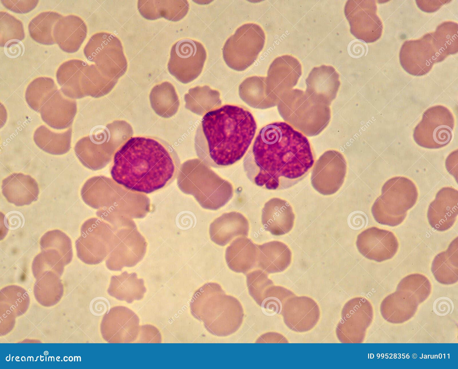 Leukemia cells stock photo. Image of examination, microscopic - 99528356