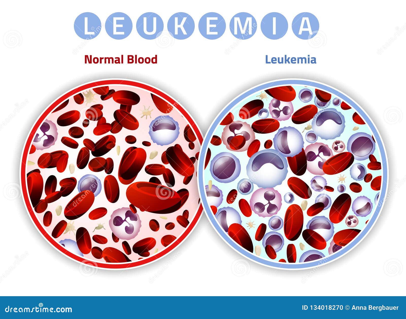 Leukemia Infographic Image stock vector. Illustration of illness ...