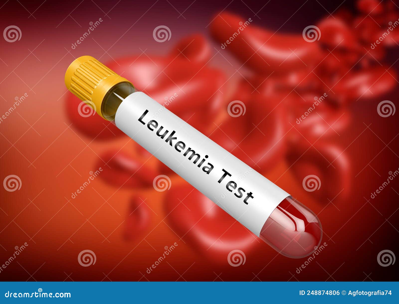 Leukemia Test on Blood Sample in Test Tube Stock Illustration ...