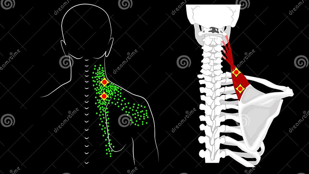 Levator Scapulae Muscle. Trigger Points and Muscle Structure. Pain in ...
