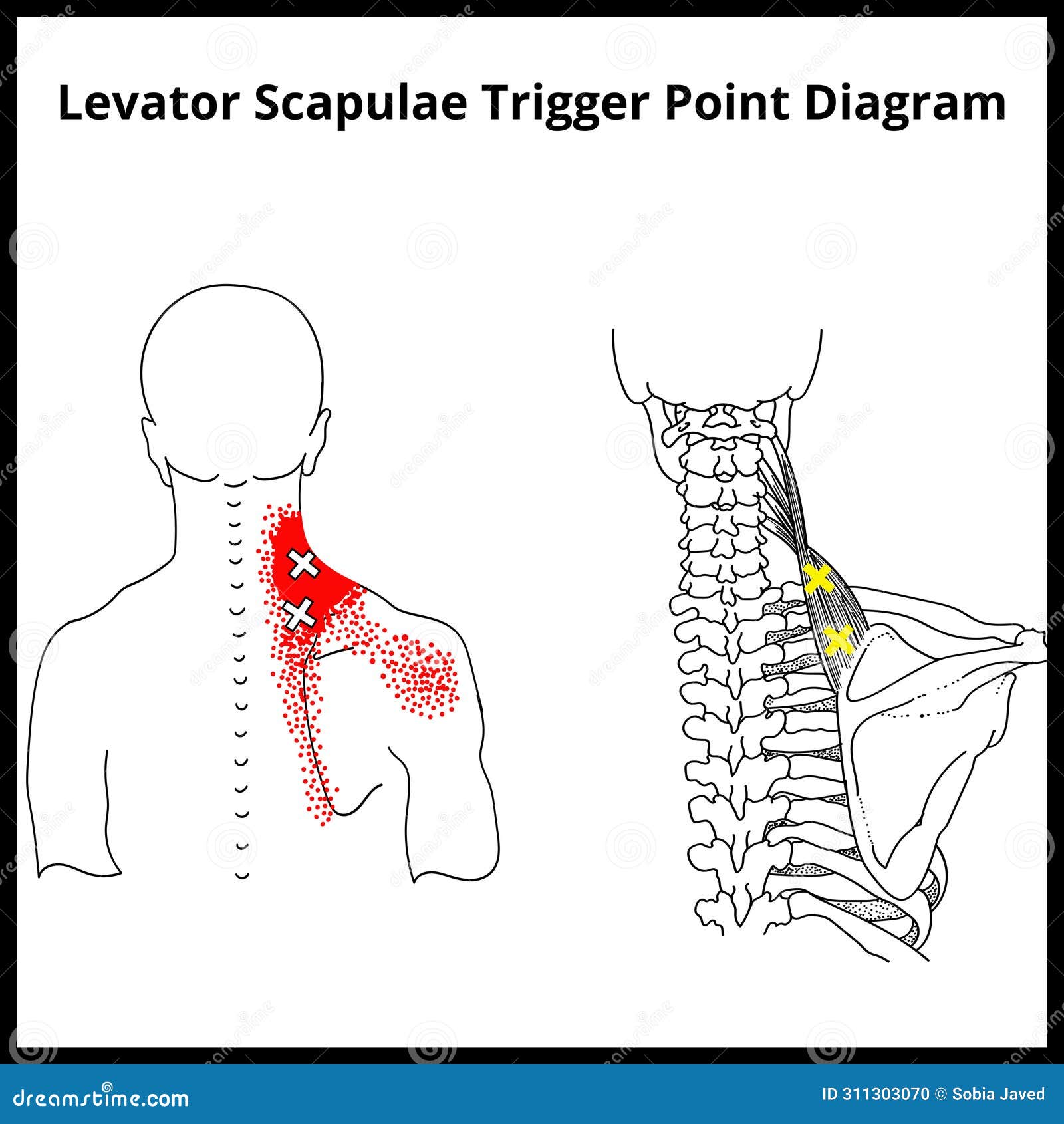 Levator Scapulae Trigger Point Diagram, Trigger Point Diagrams Vector ...