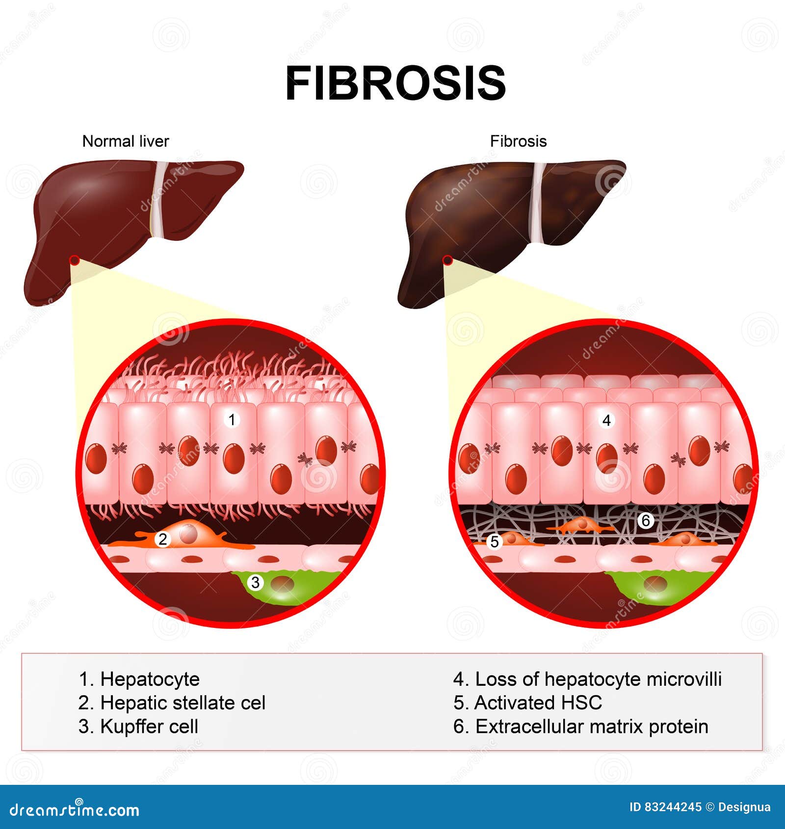 Leverfibrosis vektor illustrationer. Illustration av galla - 83244245