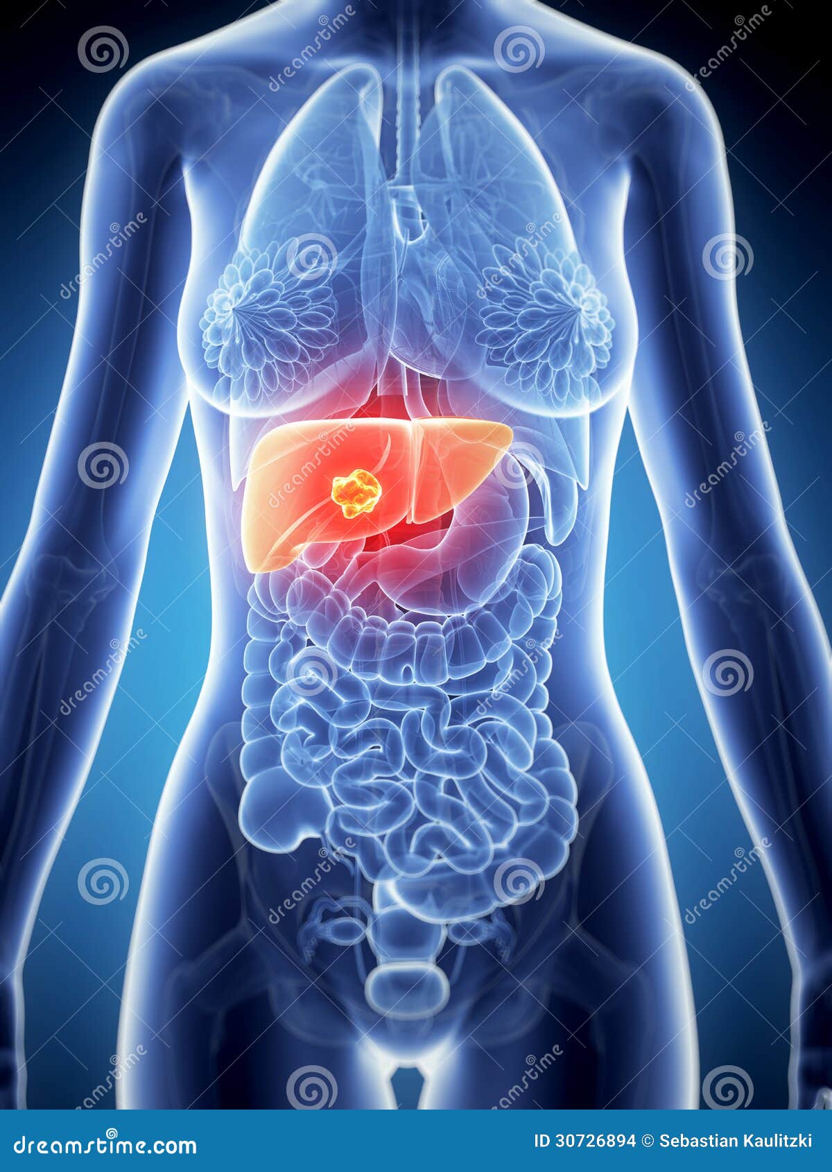 Leverkanker stock illustratie. Illustration of illustratie - 30726894