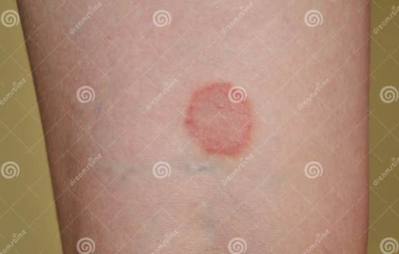 Lichen ruber planus stock photo. Image of rash, allergies - 15013874