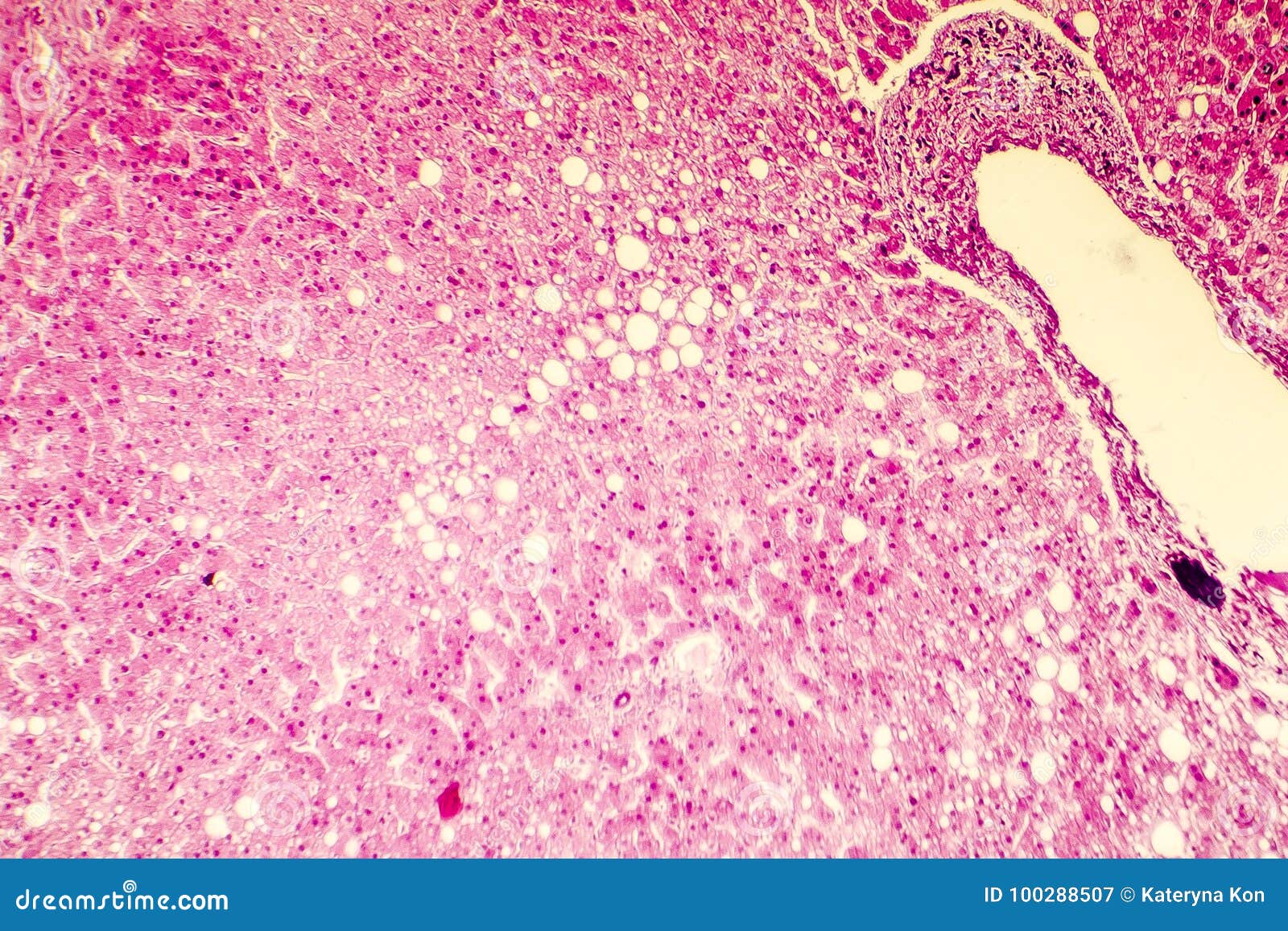 Light Micrograph of a Fatty Liver Stock Image - Image of medicine ... Light Micrograph of a Fatty Liver Stock Image - Image of medicine ...