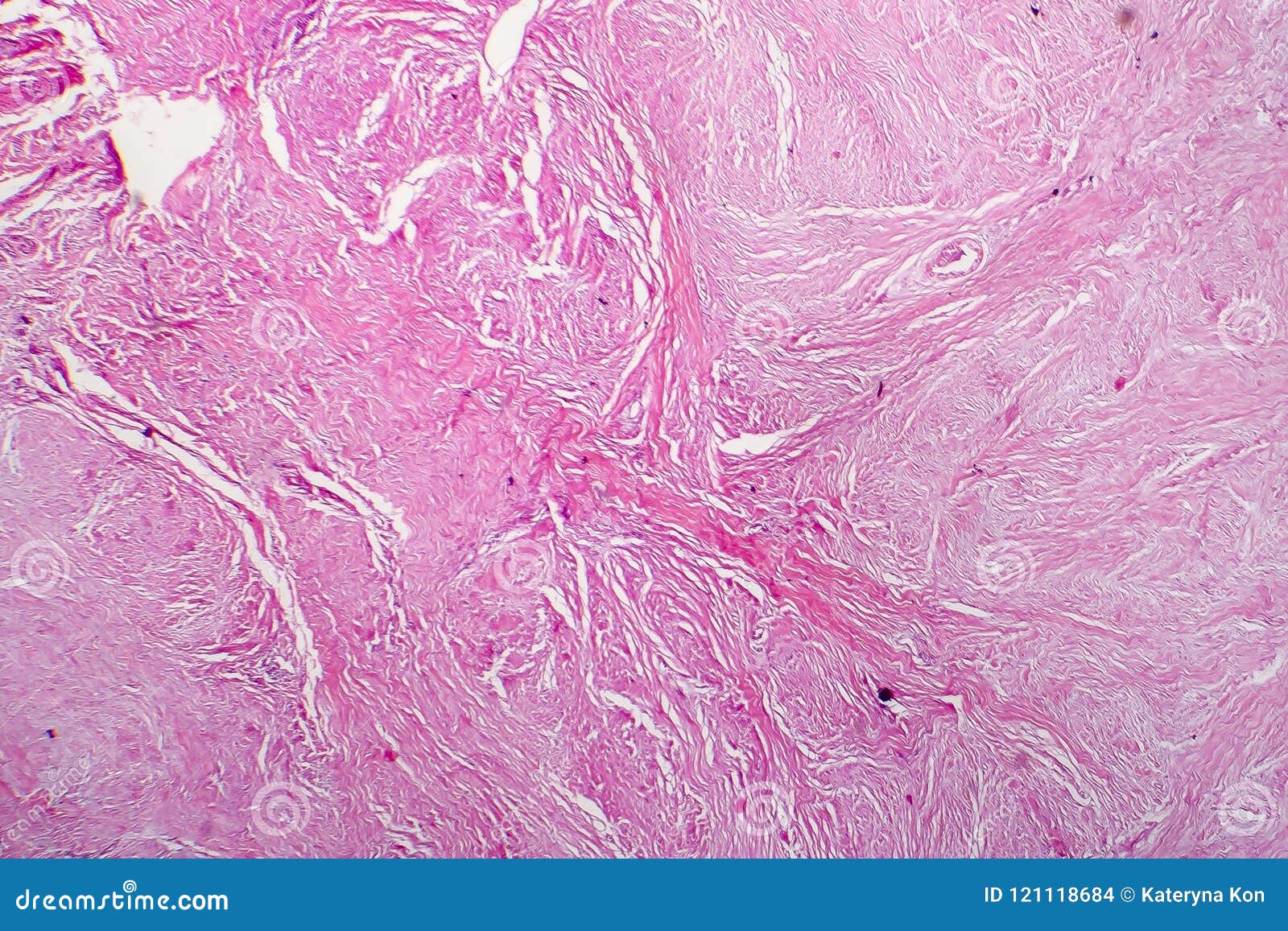 Light Micrograph of Scar Tissue Stock Photo - Image of scar ...