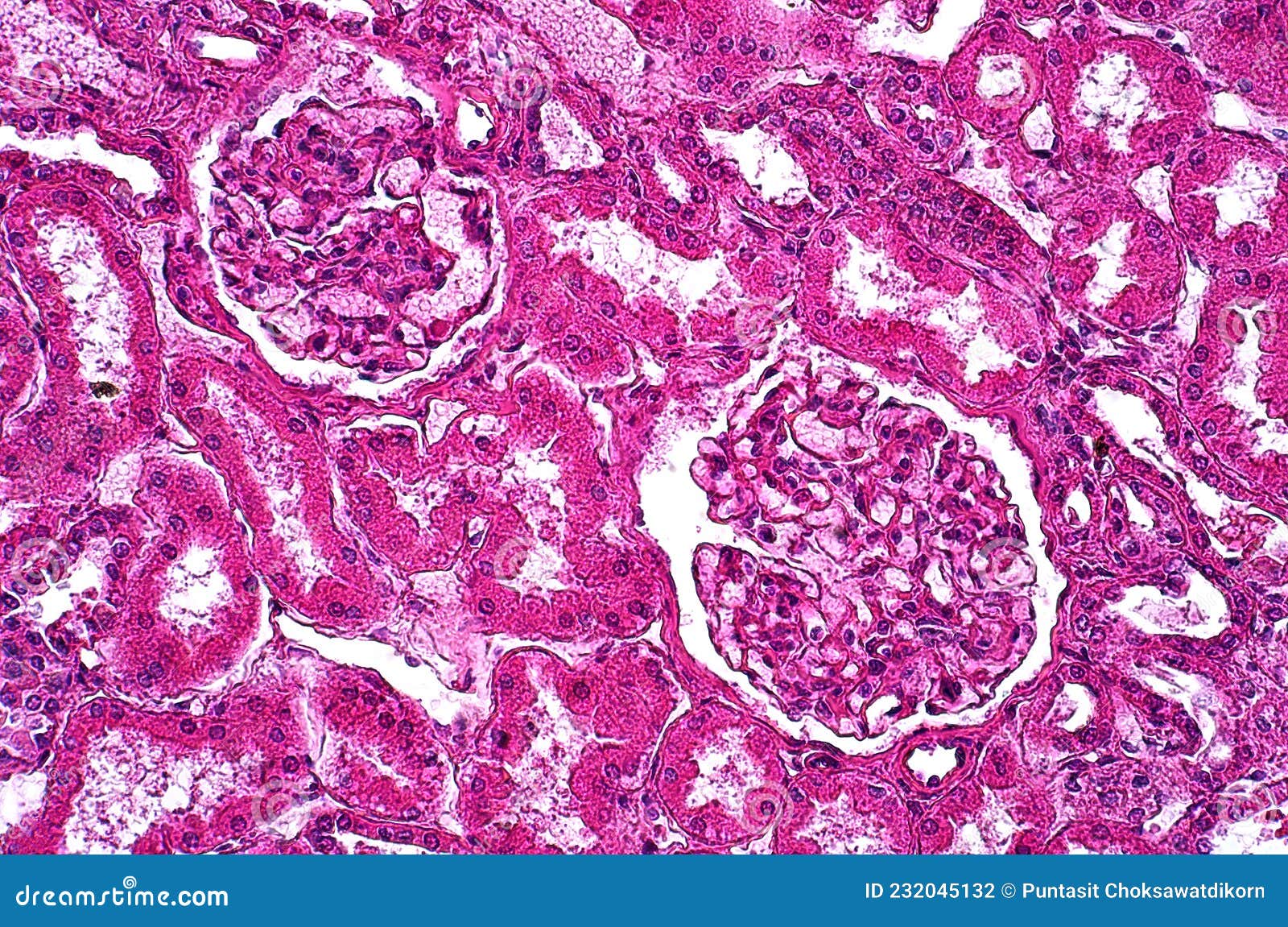 Light Microscope Glycogenosis of Liver Pathology Stock Photo - Image of ...
