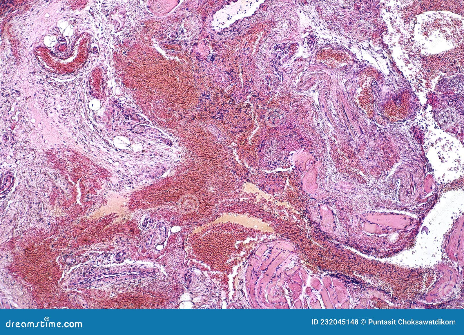 Light Microscope Tonsillitis Pathology Stock Photo - Image of germinal ...