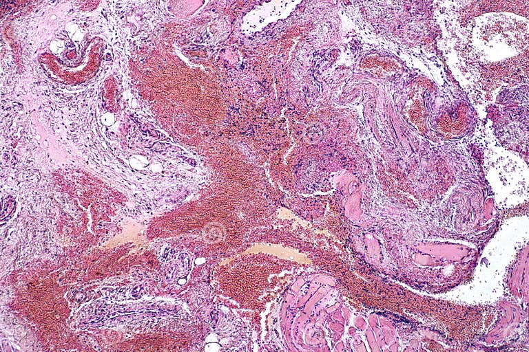 Light Microscope Tonsillitis Pathology Stock Photo - Image of germinal ...