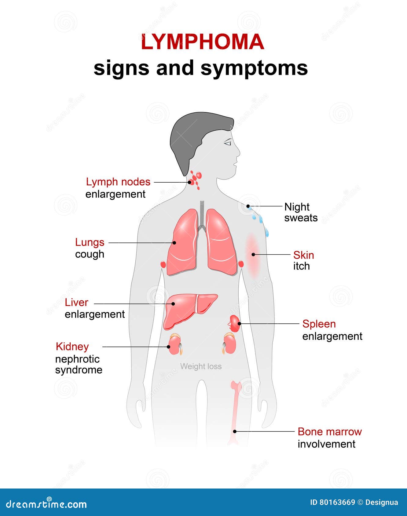 Linfoma : Linfoma No Hodgkin Que Es Causas Y Sintomas 3FF