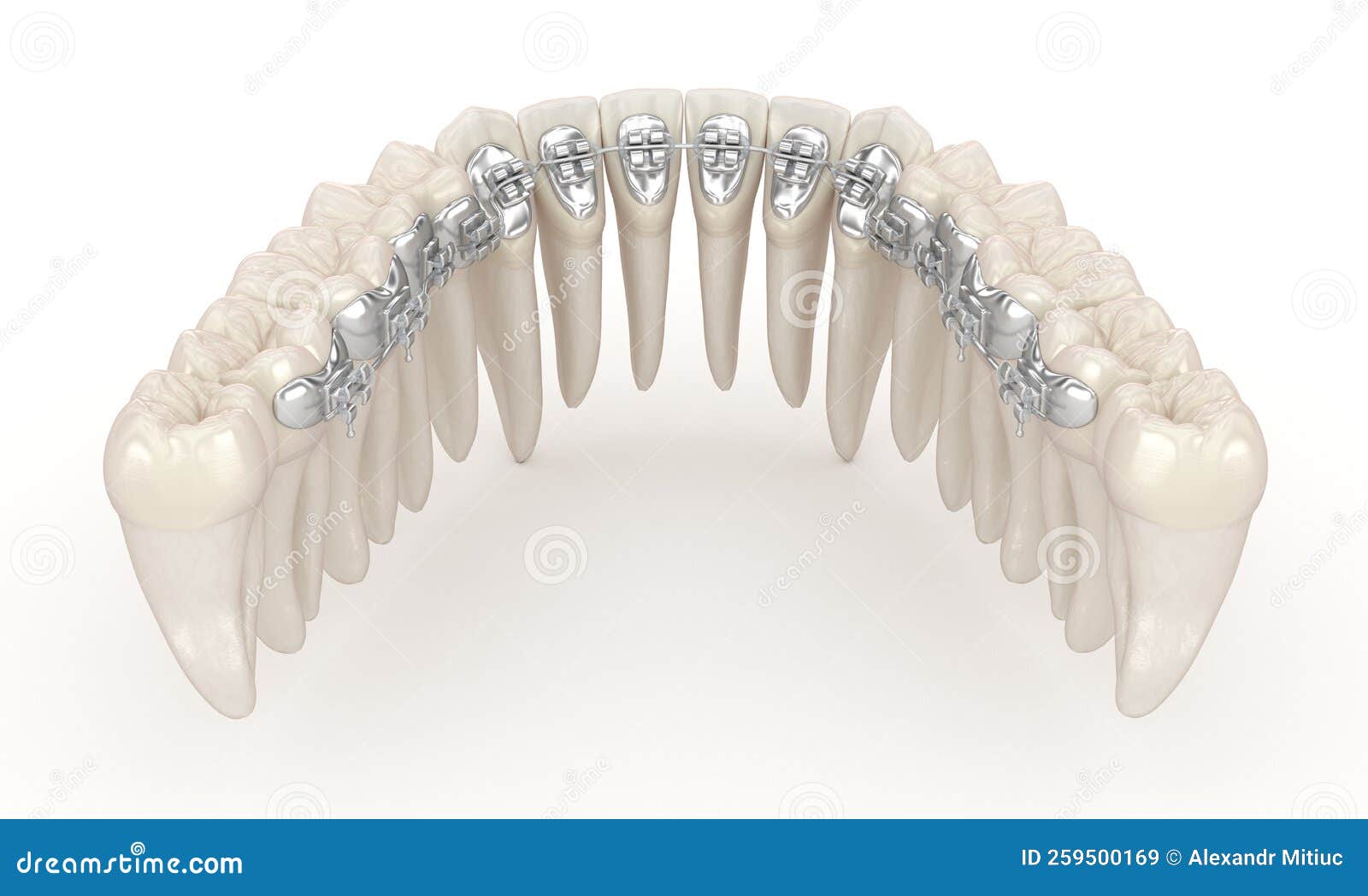 Lingual Braces System. 3D Illustration Concept of Silver Braces Stock ...