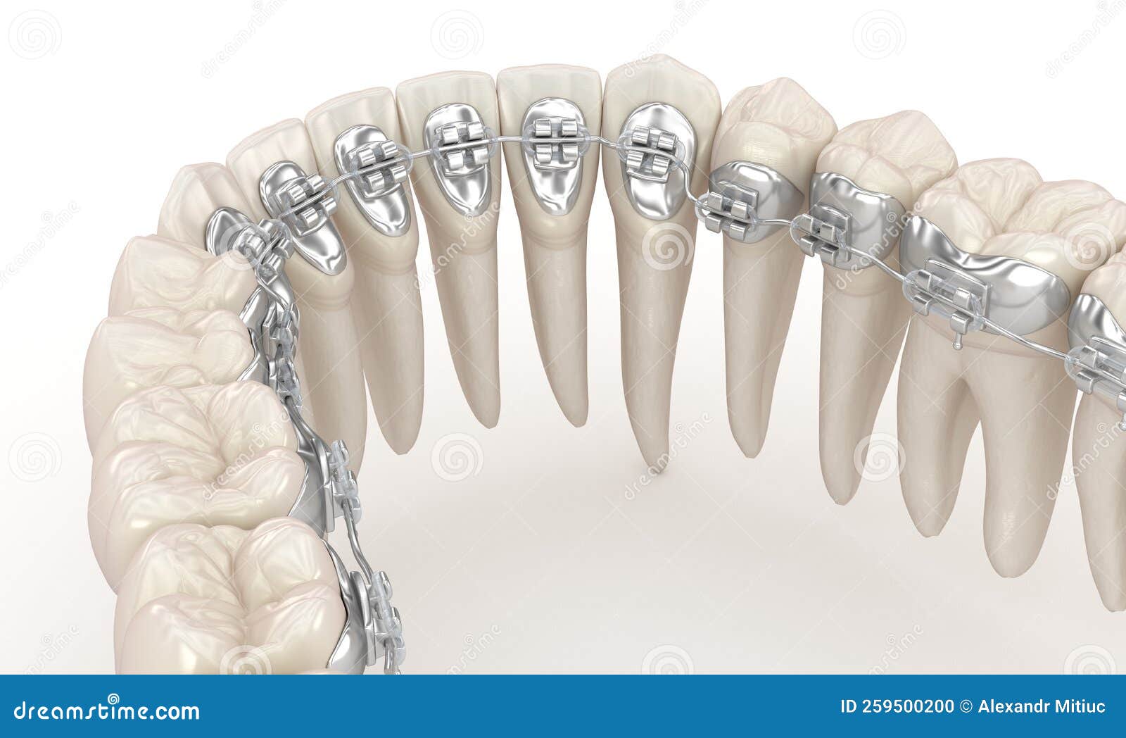 Lingual Braces System. 3D Illustration Concept of Silver Braces Stock ...