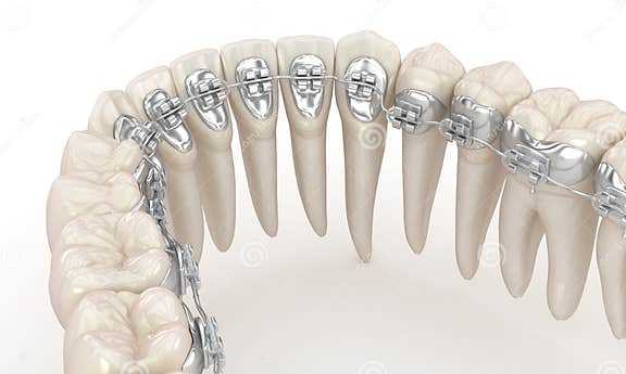 Lingual Braces System. 3D Illustration Concept of Silver Braces Stock ...