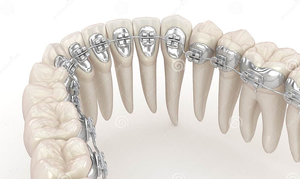 Lingual Braces System. 3D Illustration Concept of Silver Braces Stock ...