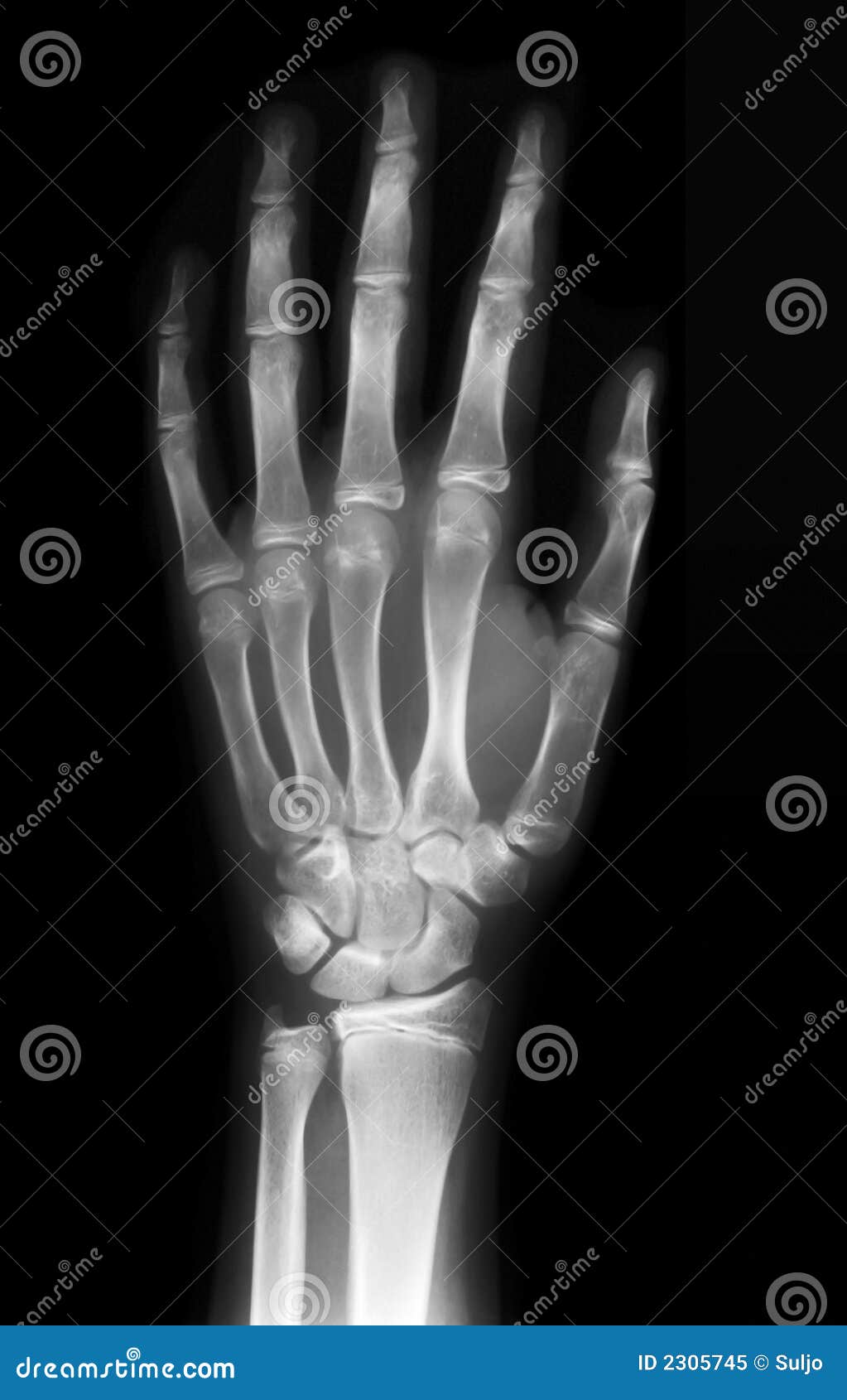 Linke Hand stockbild. Bild von handgelenke, gesundheit - 2305745