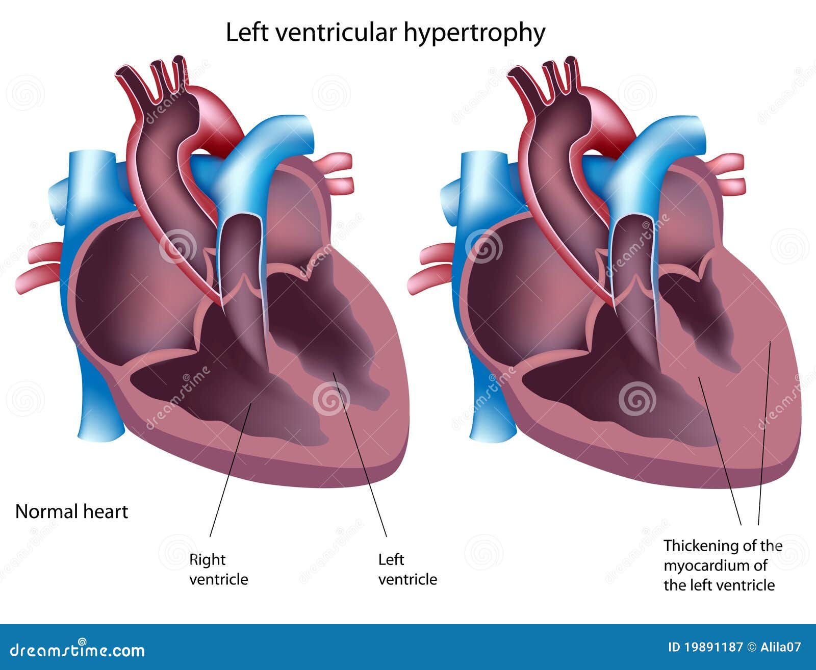 Linker Ventriculaire Hypertrofie Vector Illustratie - Illustratie ...