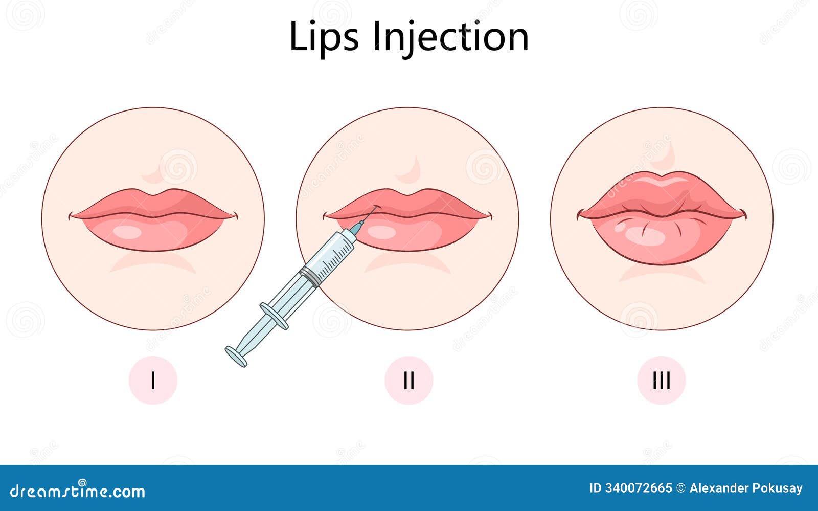 Lip Plumping Augmentation With Filler Injection Illustration Cartoon ... Lip Plumping Augmentation With Filler Injection Illustration Cartoon ...