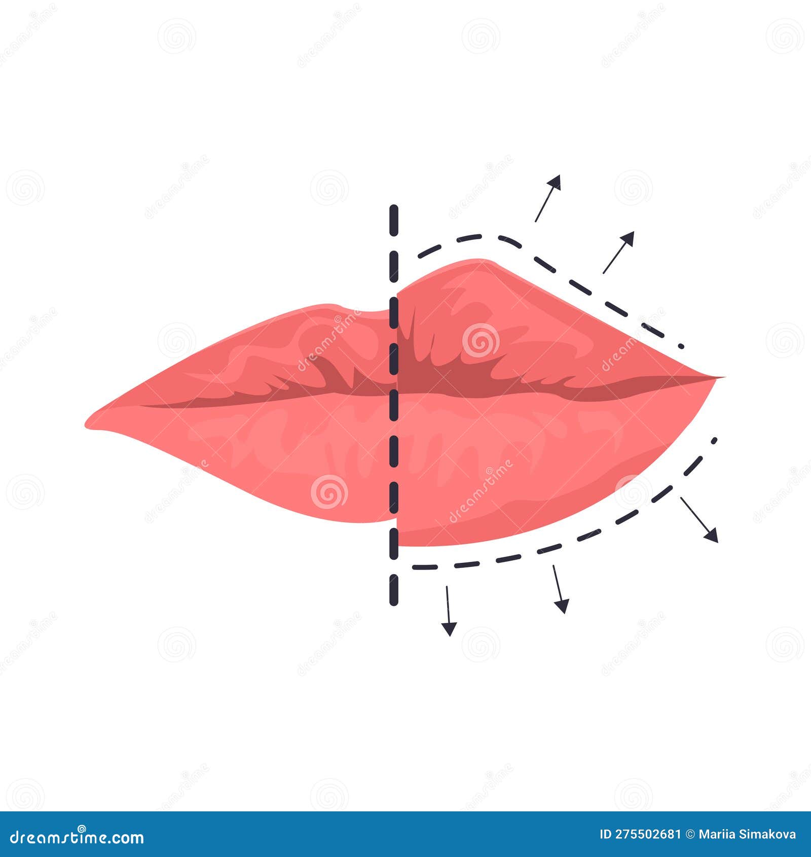Lip Augmentation Illustration in Color Cartoon Style. Editable Vector ...