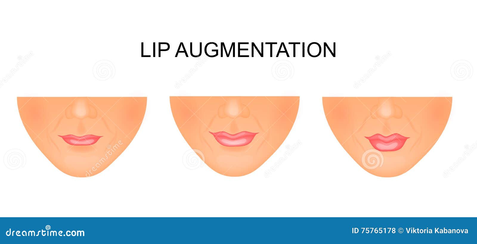 Lip Enhancement Stock Illustrations – 46 Lip Enhancement Stock ...