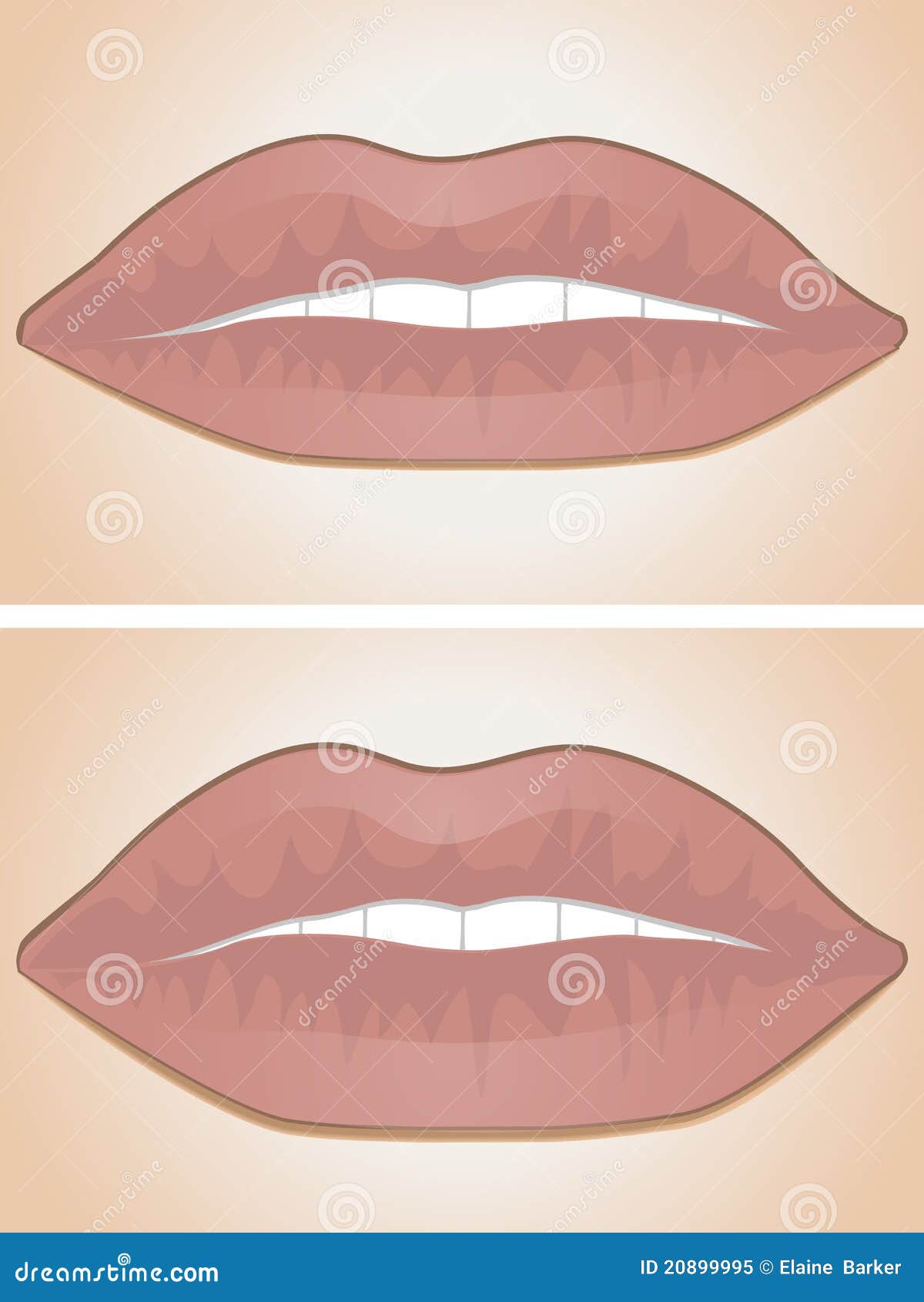 Lip Filler Before And After Cartoon Vector | CartoonDealer.com #20899995