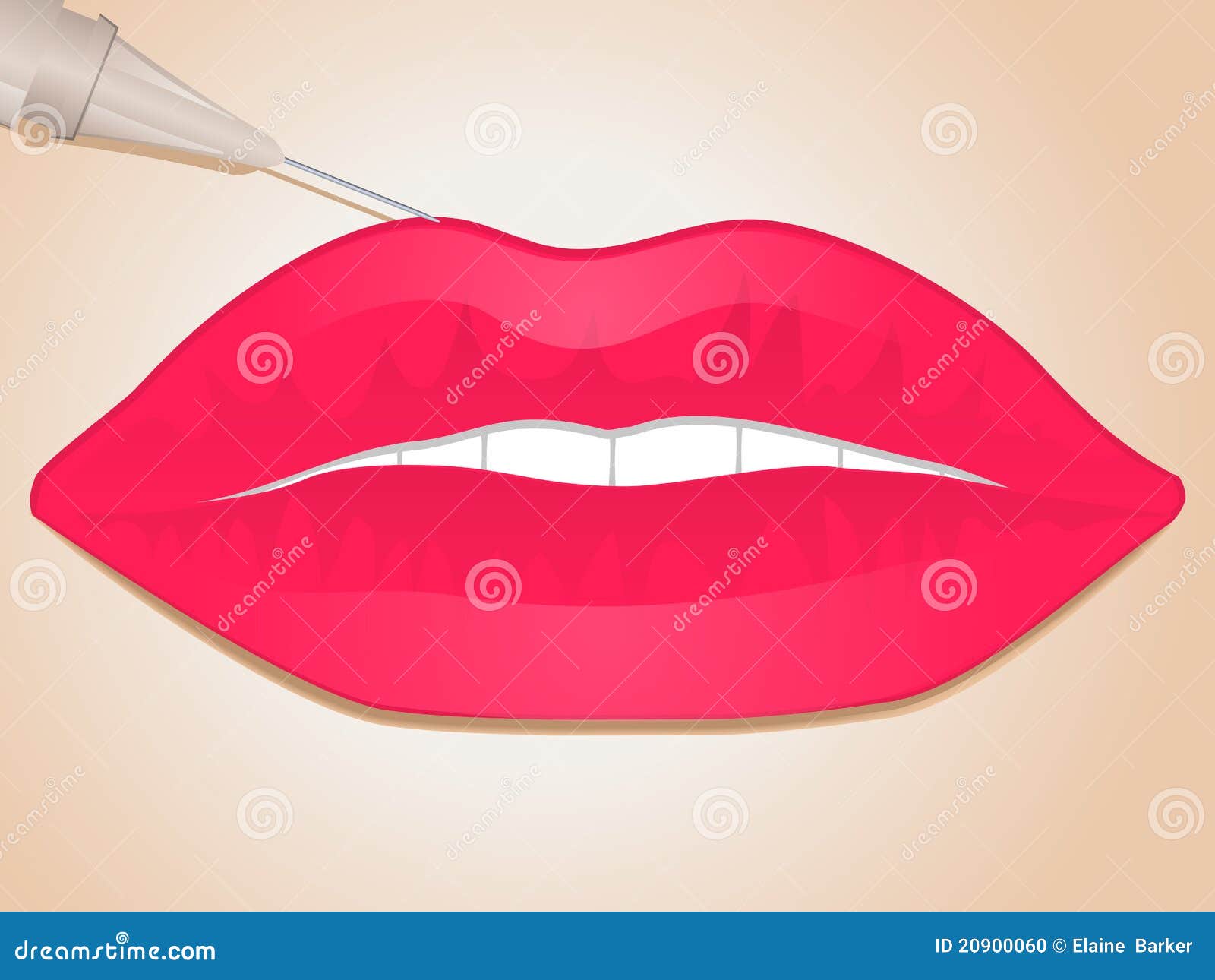 Lip Filler Before And After Cartoon Vector | CartoonDealer.com #20899995