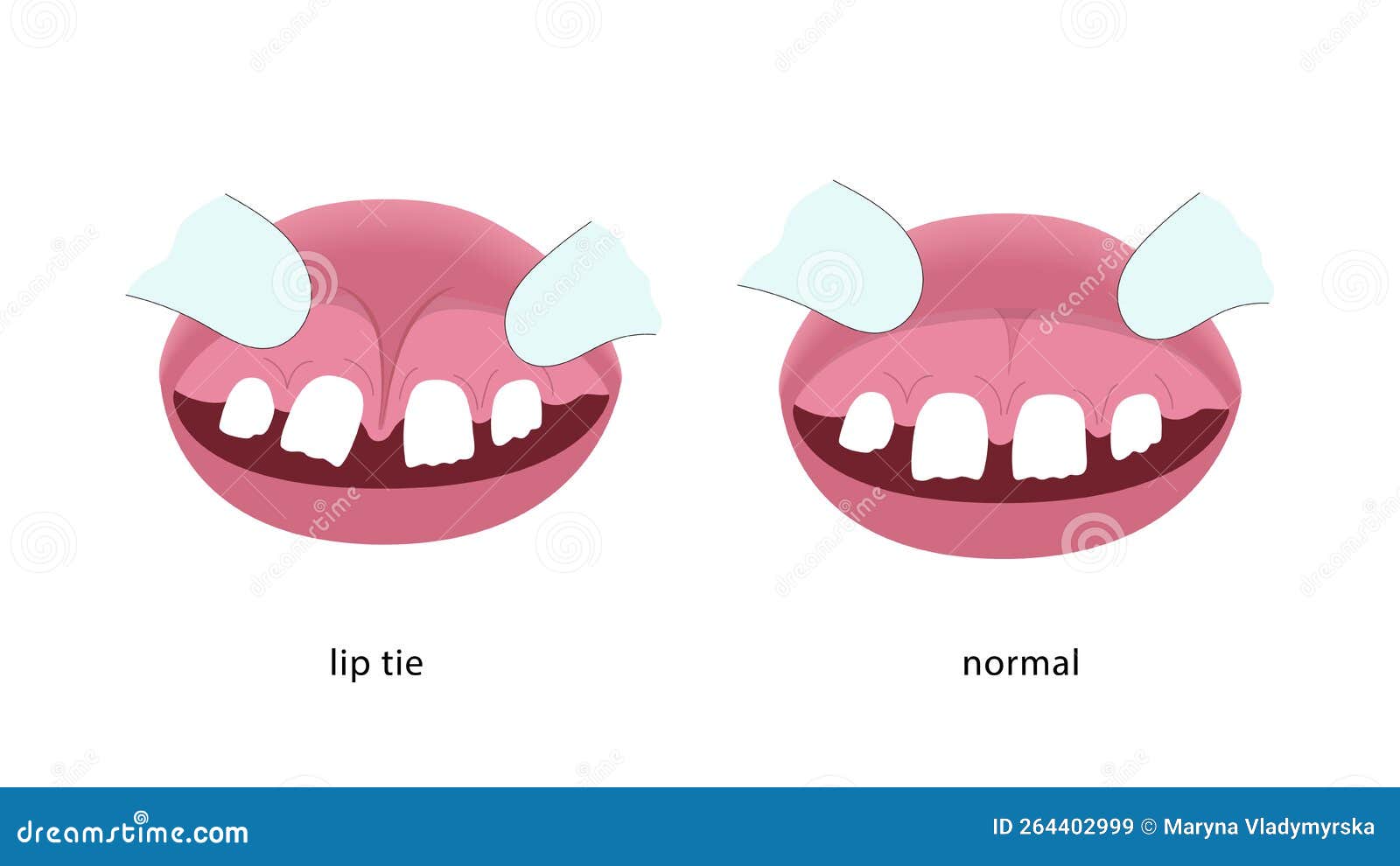 Ankyloglossia Cartoons, Illustrations & Vector Stock Images - 6 ...