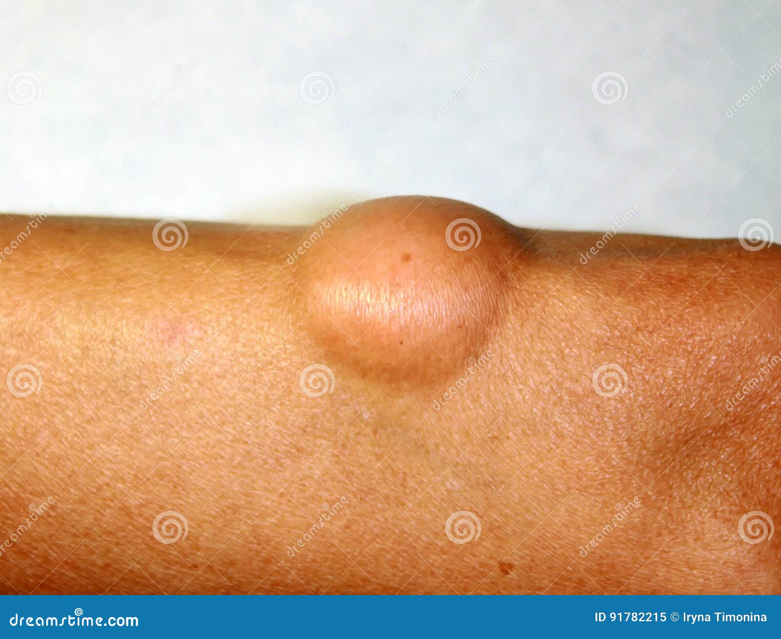 Lipom Auf Dem Ellbogen Des Armes Stockbild - Bild von wachsen ...