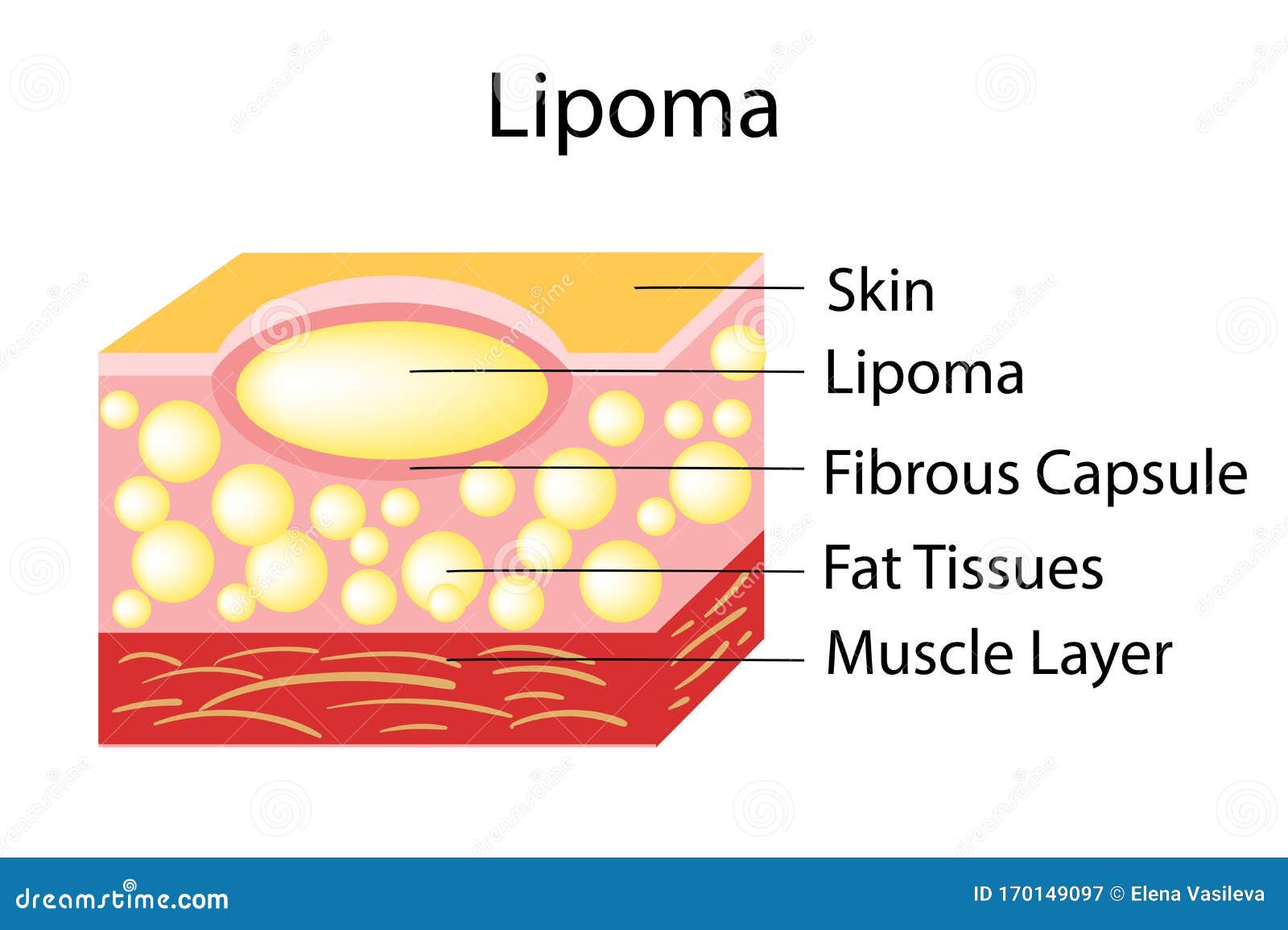 Lipoma are Adipose Tumors Located in the Subcutaneous Tissues. Stock ...