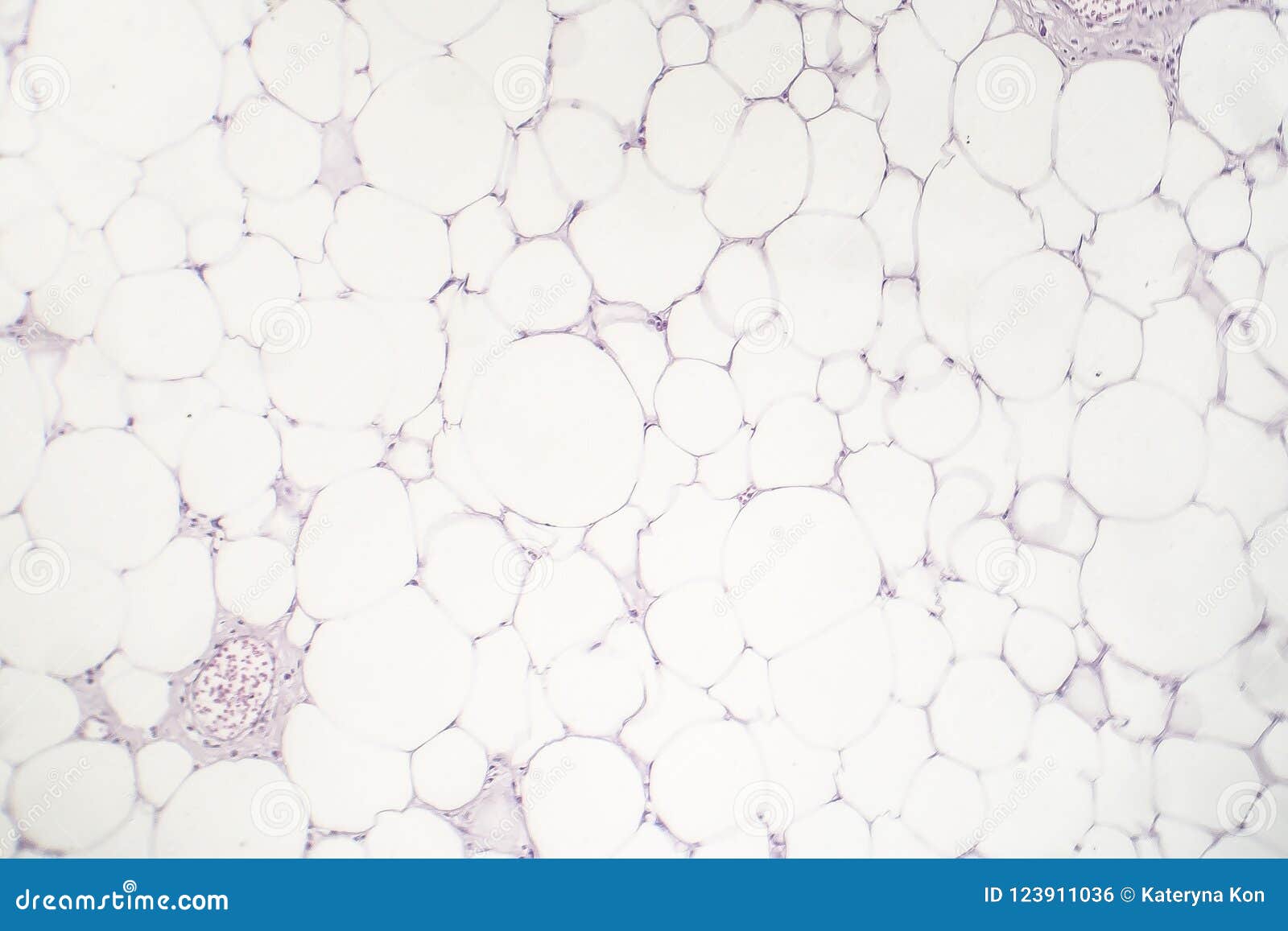 Lipoma, Benign Growth of Fatty Tissue Stock Photo - Image of adipose ...