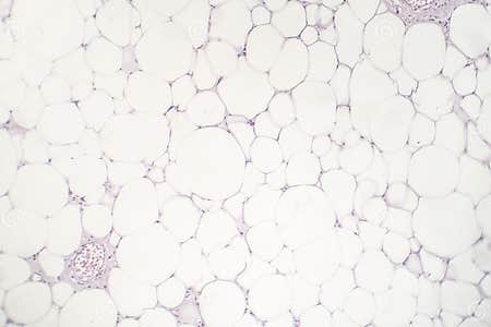 Lipoma, Benign Growth of Fatty Tissue Stock Photo - Image of adipose ...