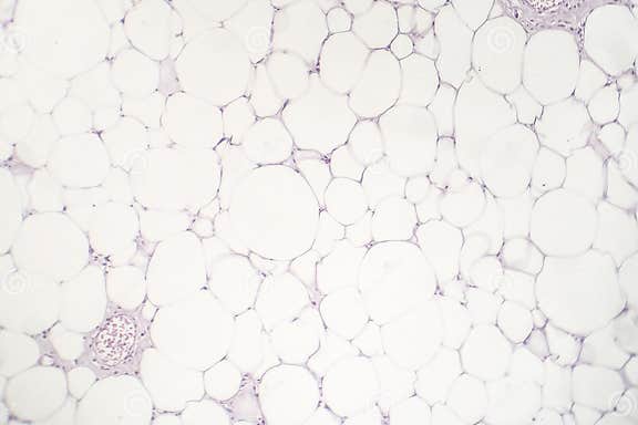 Lipoma, Benign Growth of Fatty Tissue Stock Photo - Image of adipose ...