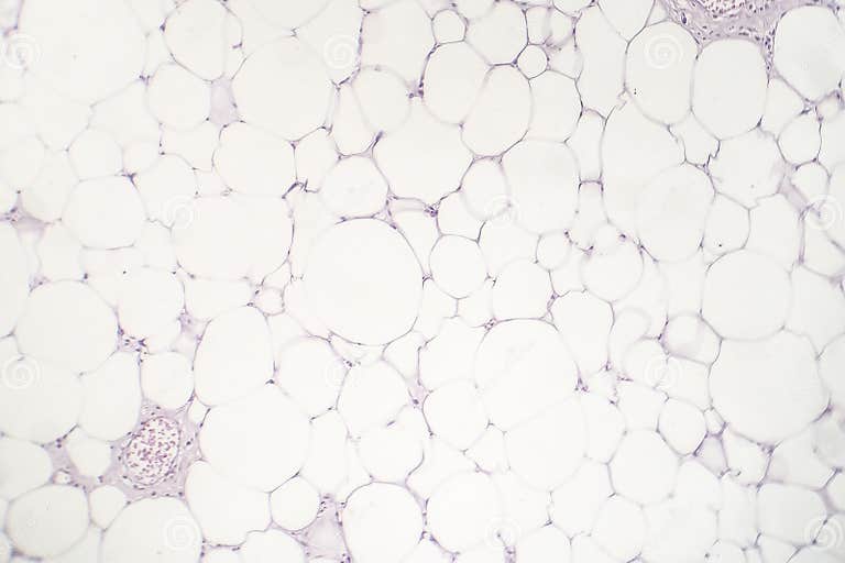 Lipoma, Benign Growth of Fatty Tissue Stock Photo - Image of adipose ...