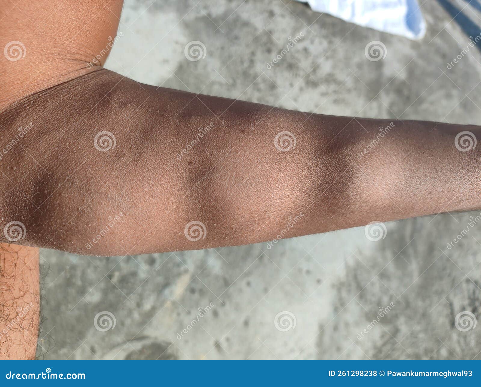 Lipoma Knots on the Left Forearm of a Young Man Stock Photo - Image of ...
