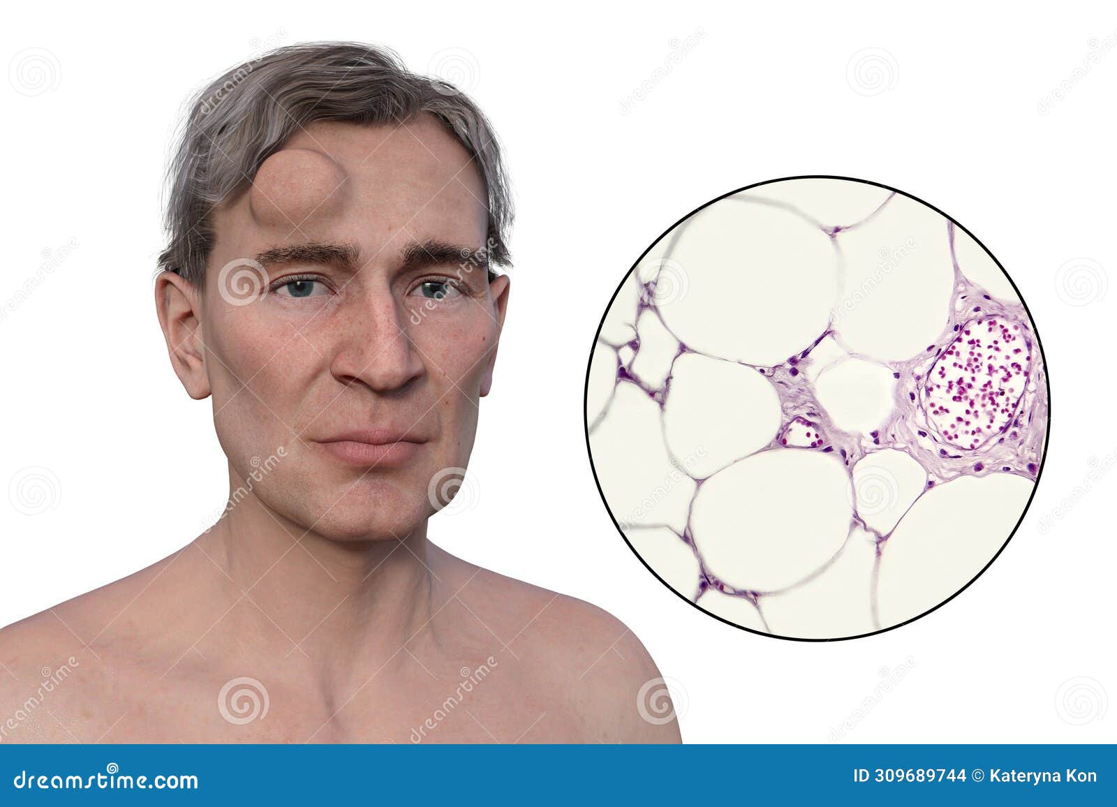 Lipoma on a Man S Forehead, 3D Illustration and Micrograph Stock ...