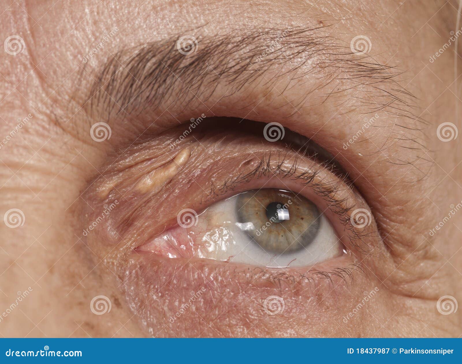 Lipoma - Pimple immagine stock. Immagine di eyeball, salute - 18437987
